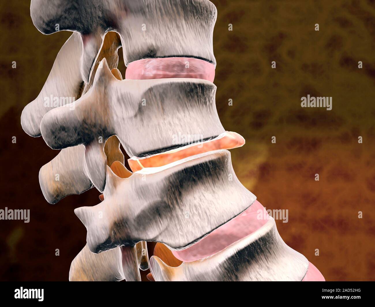 Slipped intervertebral disc. Illustration of a side view of the spine ...