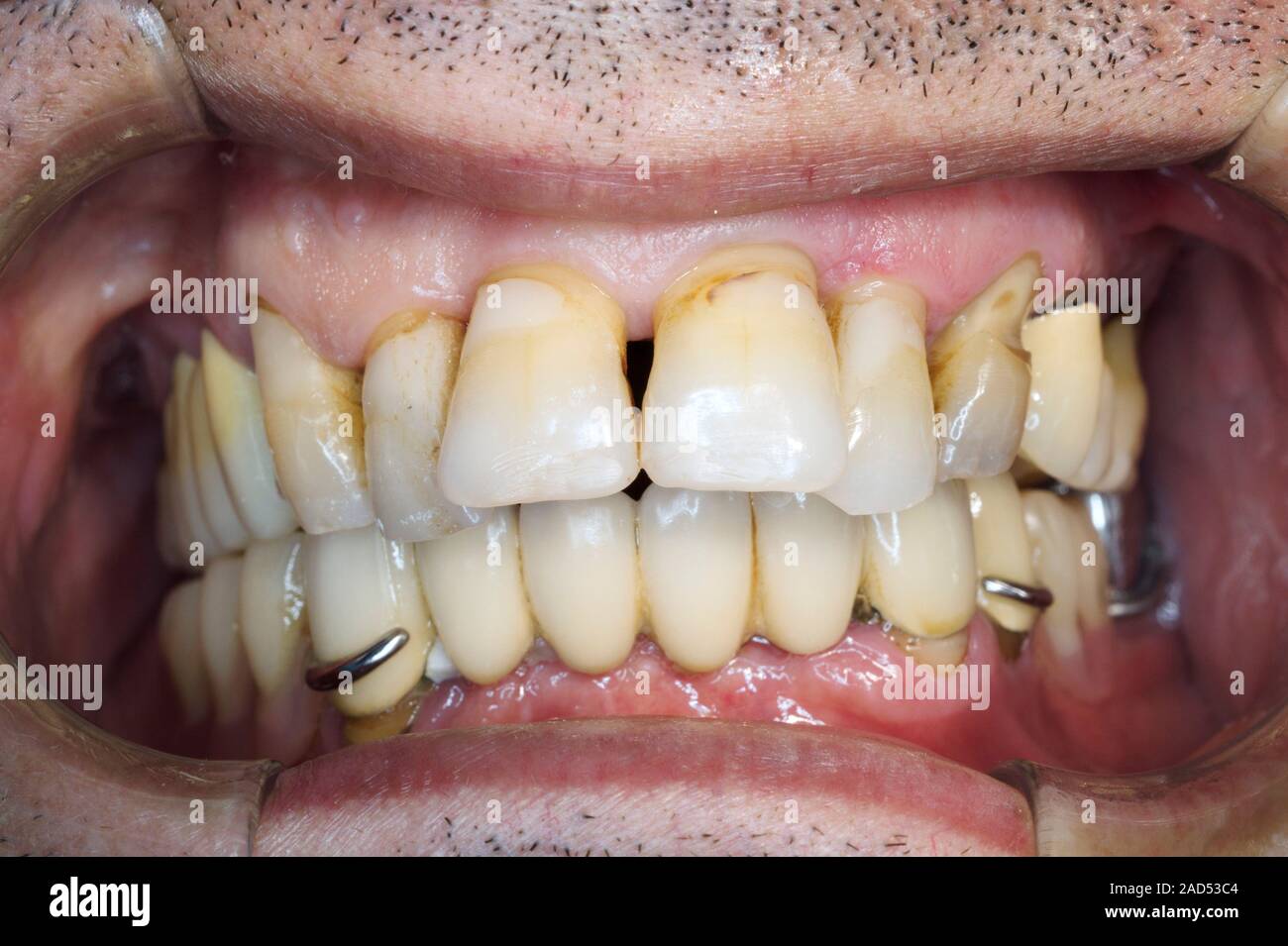 Open bite. Close up the teeth of a 57-year-old man with large central ...