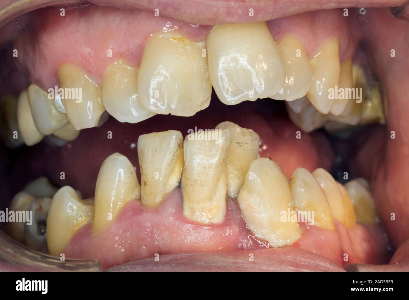 Dental tartar. Close-up of the mouth of a 23-year-old man, showing ...