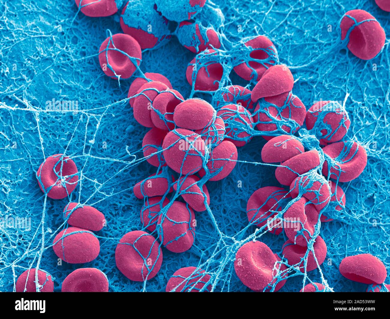 Clot forming in lung tissue, coloured scanning electron micrograph (SEM ...