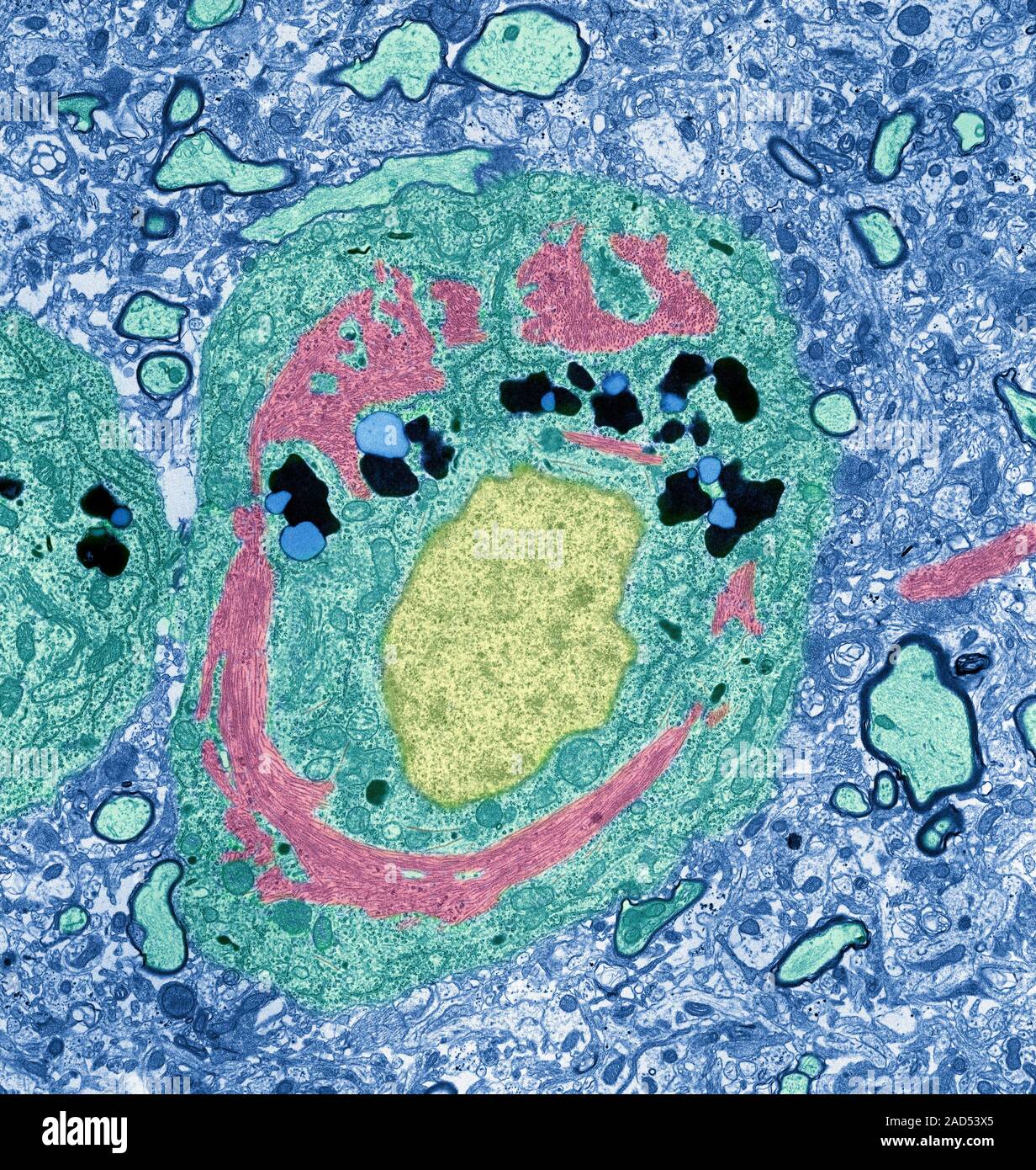 Neuron in Alzheimer's disease, coloured transmission electron ...