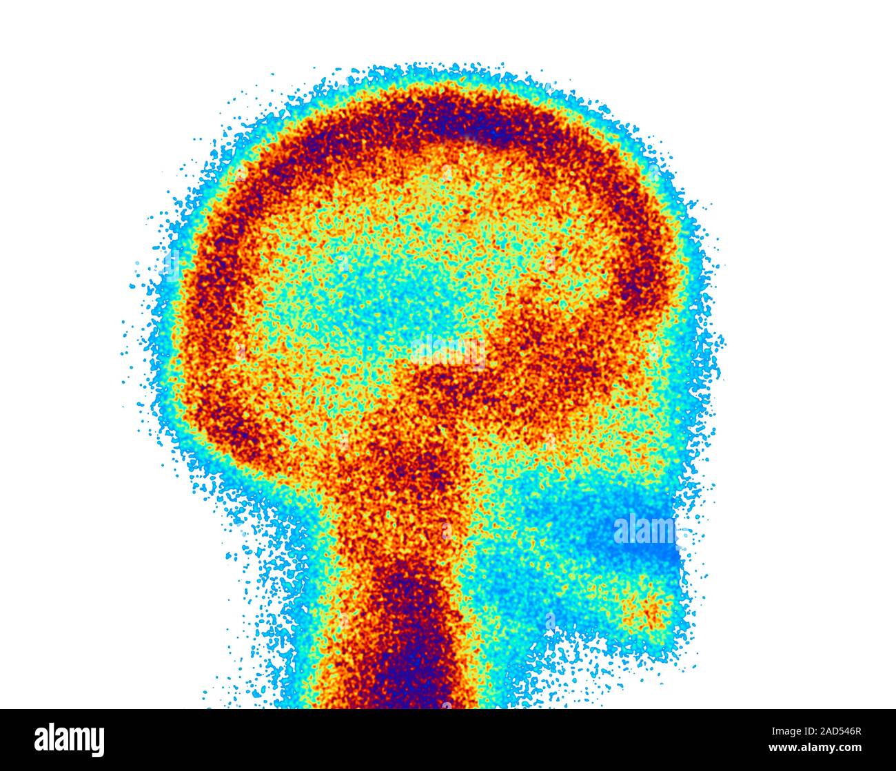 Coloured bone scintigraphy of a head depicting a normal bone structure ...
