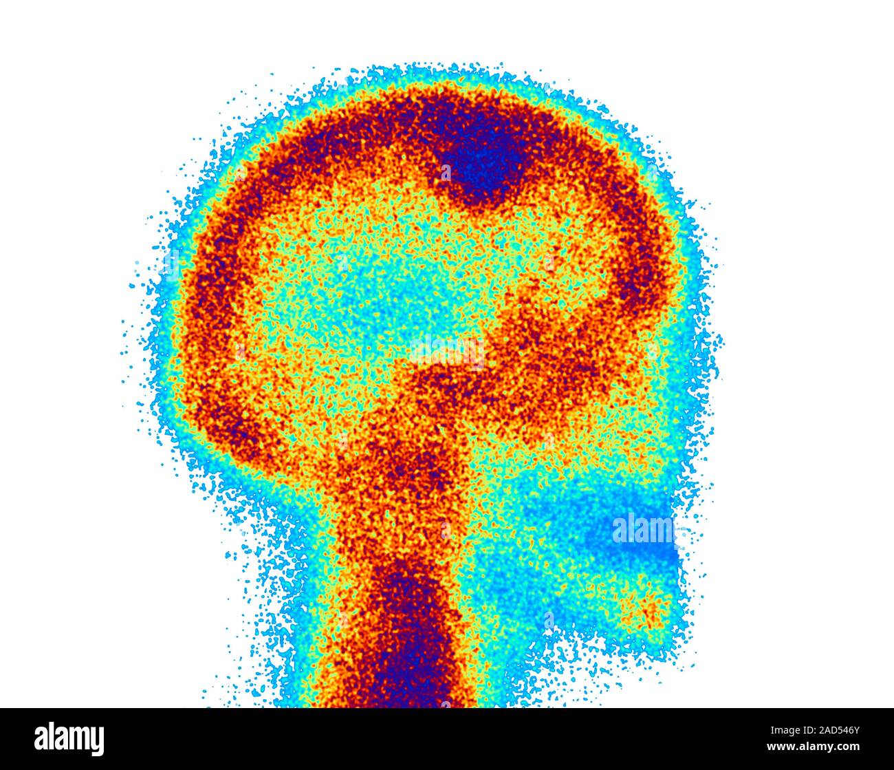 Coloured bone scintigraphy of a head showing a tumour (osteomeningioma ...