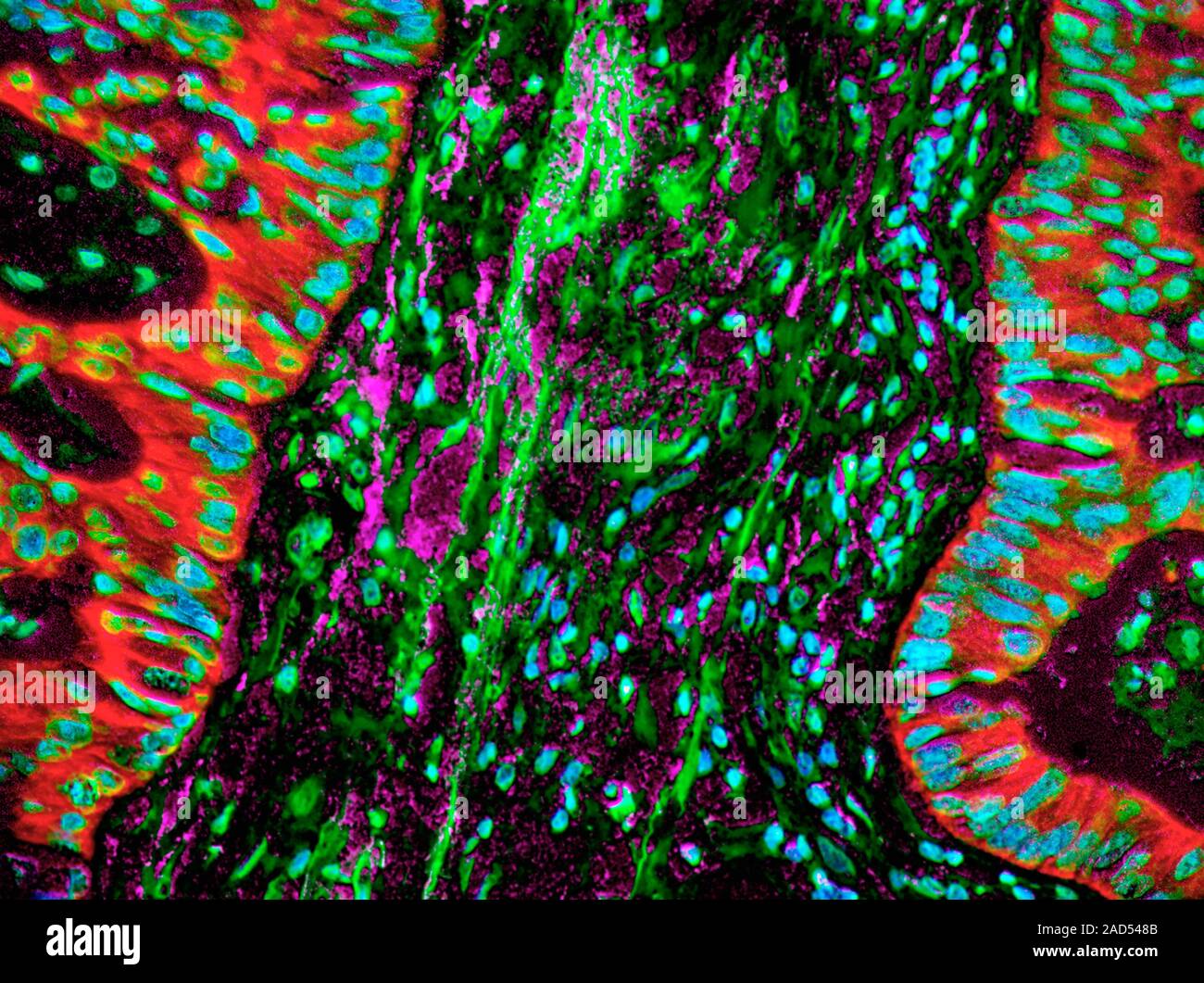 Lung cancer desmoplasia. Fluorescence light micrograph of a stromal ...
