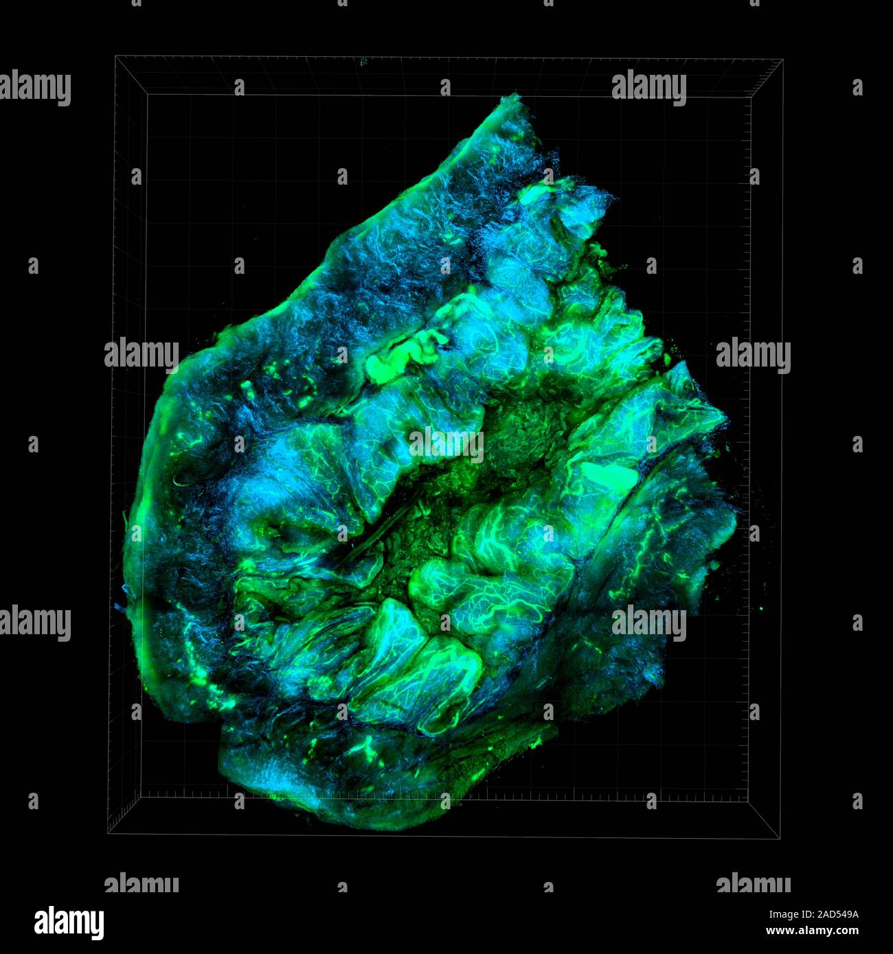 Ovarian cancer. Optical tissue clearing image of tissue from an ovarian ...