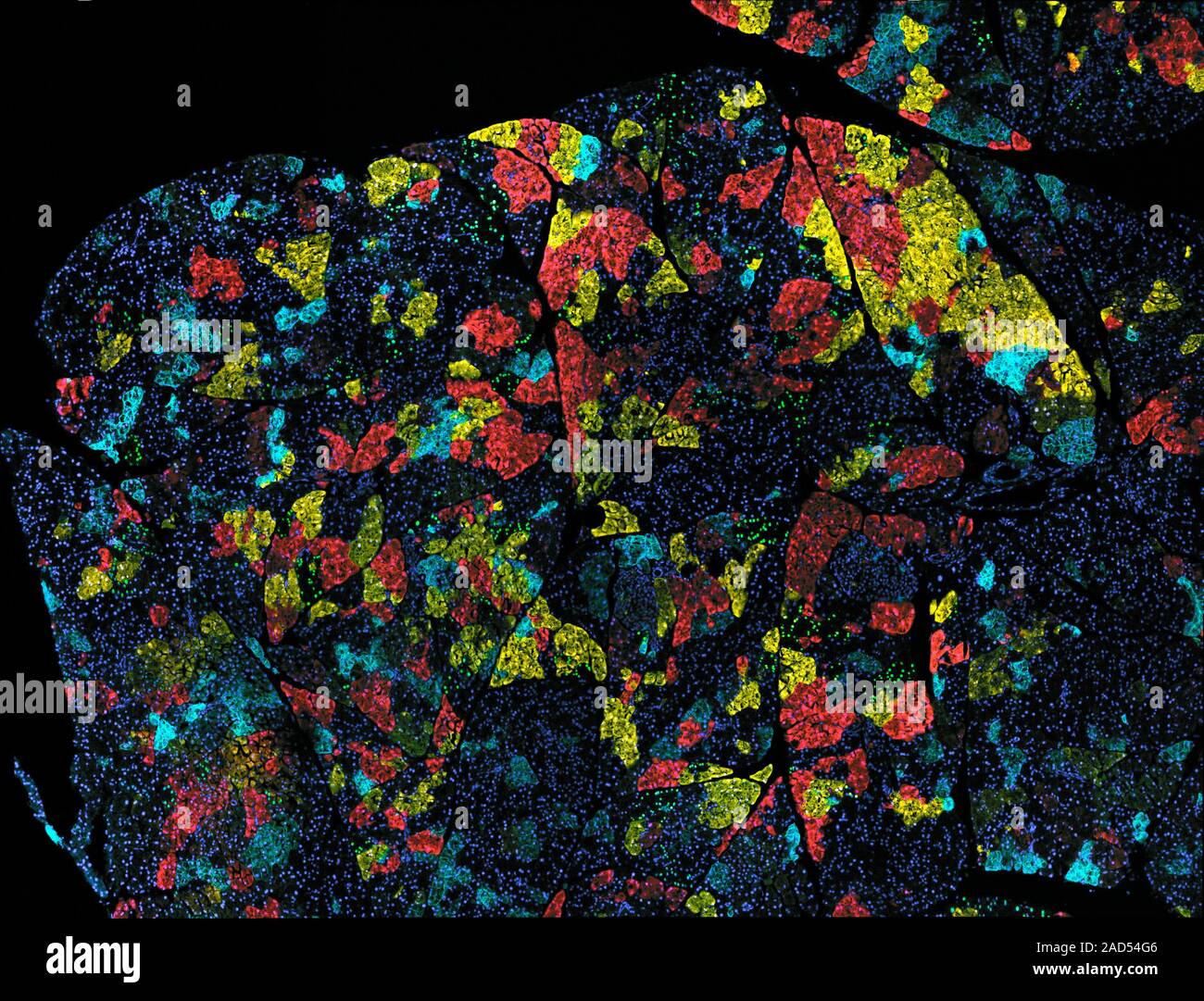 Pancreatic cancer research. Pancreatic tissue with multi-colour lineage ...