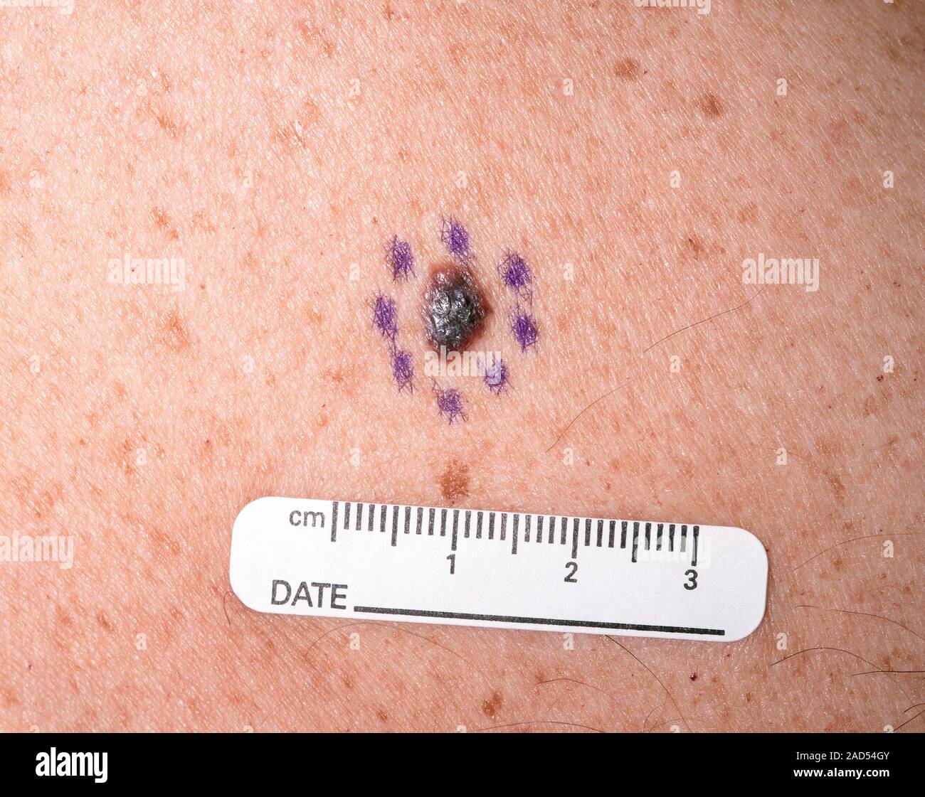 Malignant melanoma, with a scale bar to show the size. This case ...