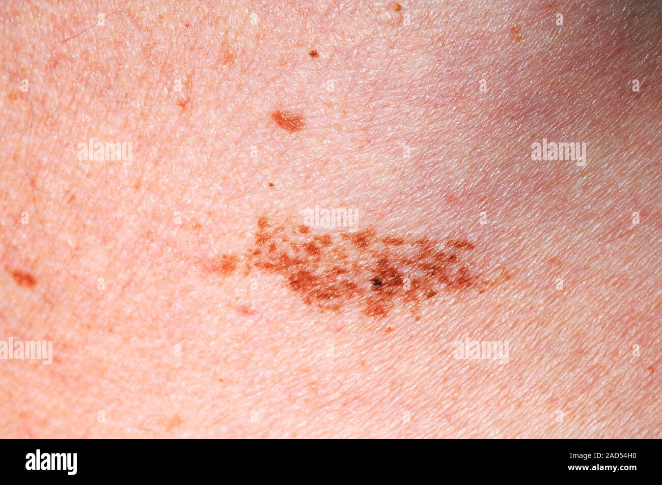 Naevus spilus, benign skin growth. Close-up of a collection of flat ...