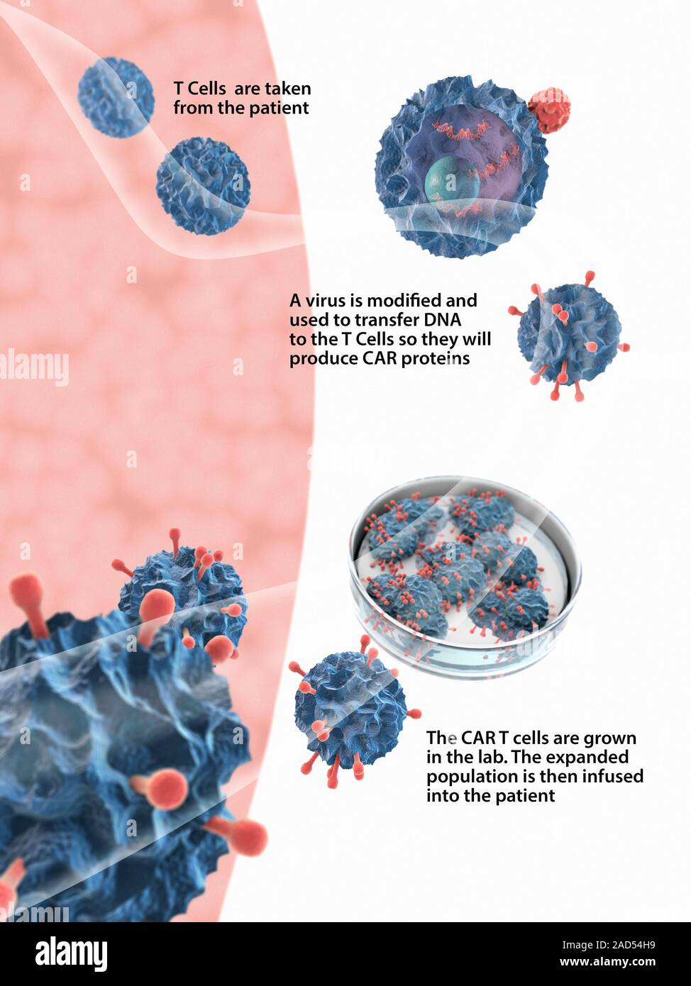 CAR T cell cancer immunotherapy. Illustration of the stages involved in ...