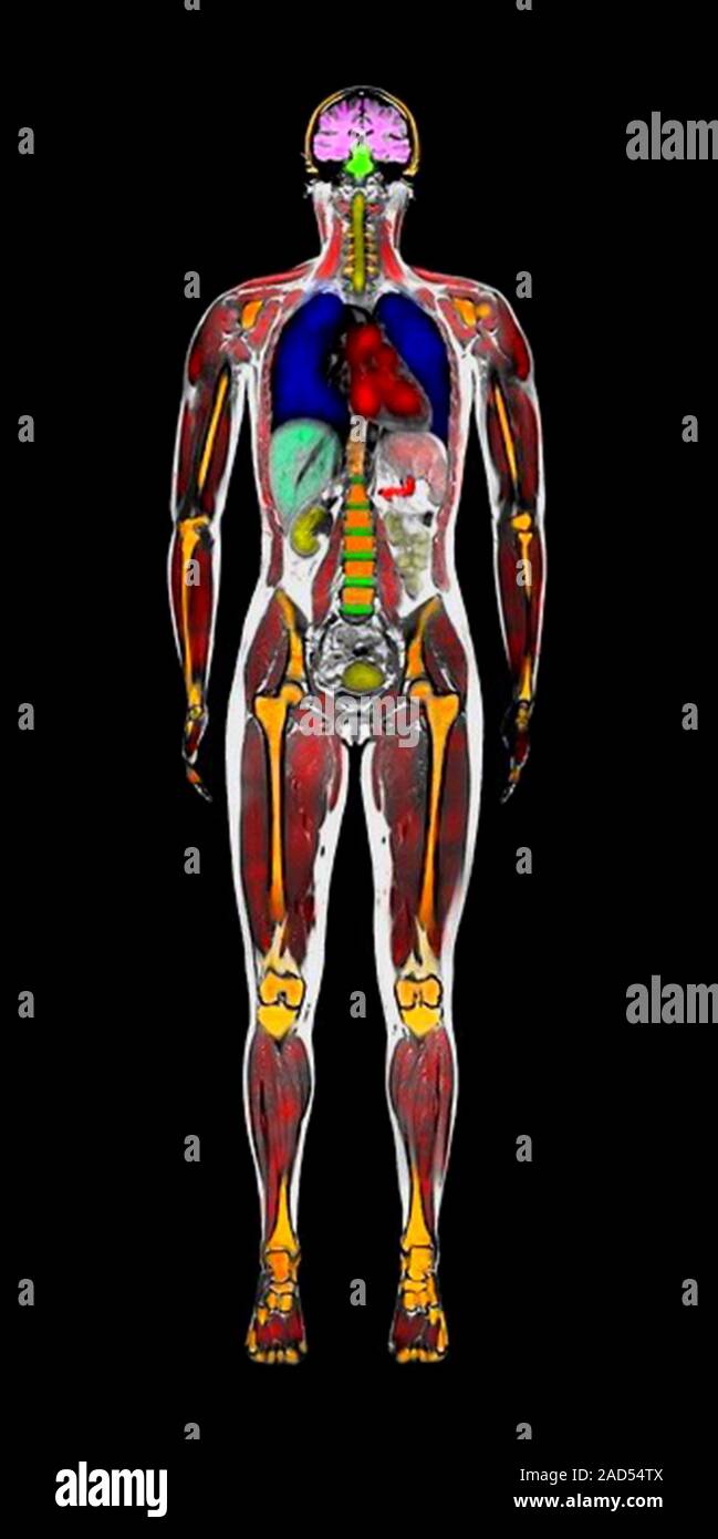 Whole body, coronal MRI scan. Coloured coronal magnetic resonance ...