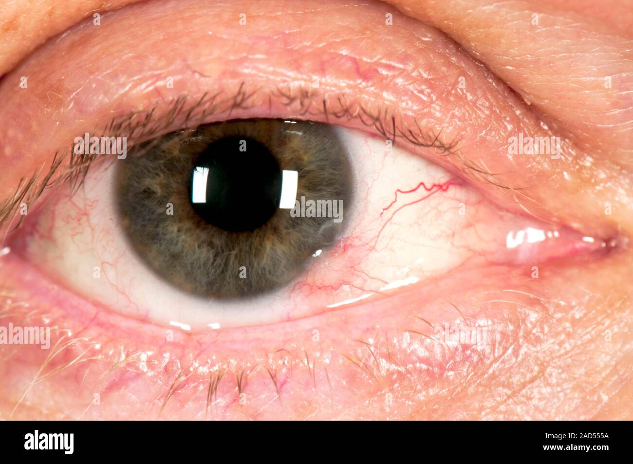Phlyctenule in the eye of a 58-year-old male patient. A phlyctenule or ...