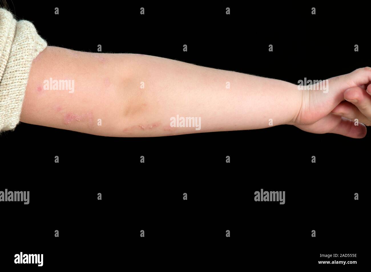 Inflammatory linear verrucous epidermal naevus (ILVEN) on the arm of a ...