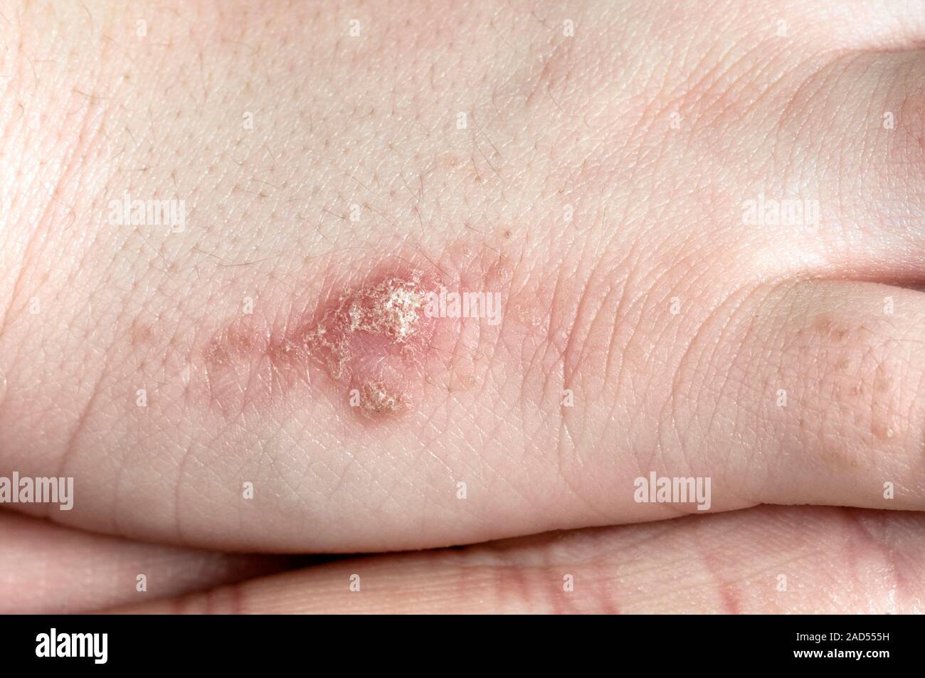 Inflammatory linear verrucous epidermal naevus (ILVEN) on the hand of a 4-year-old girl. ILVEN ...