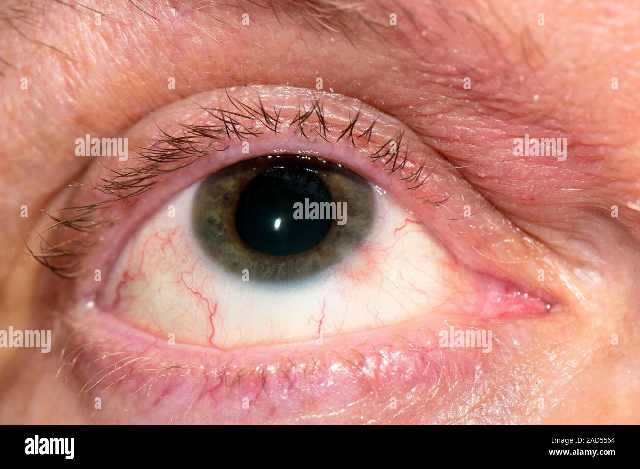 Phlyctenule in the eye of a 58-year-old male patient. A phlyctenule or ...