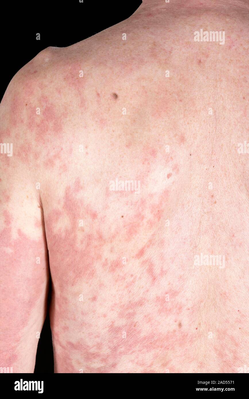 Psoriasis. Psoriasis affecting the shoulder and arm of a 70-year-old ...