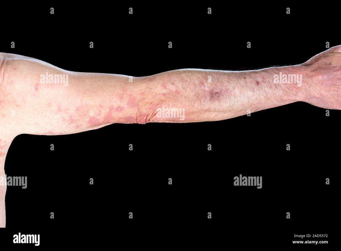 Psoriasis. Psoriasis affecting the arm of a 70-year-old male patient ...