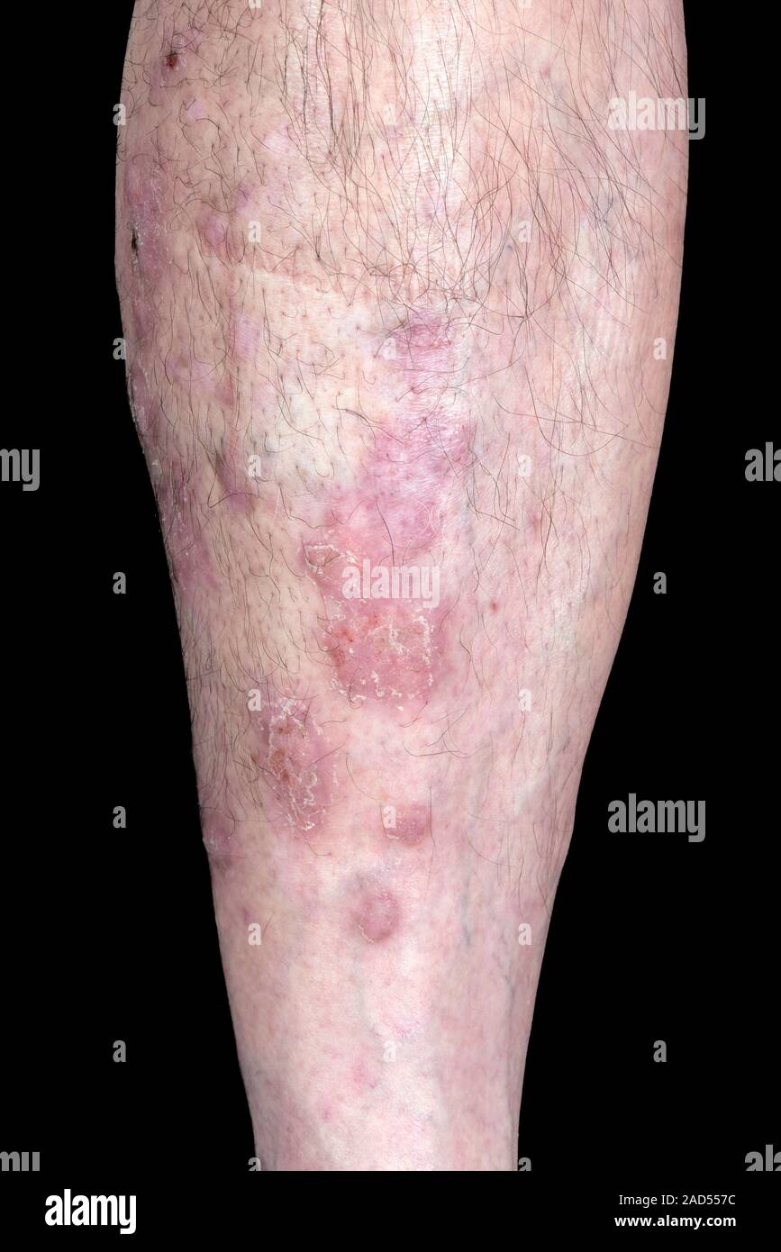 Psoriasis. Psoriasis affecting the lower leg of a 70-year-old male ...
