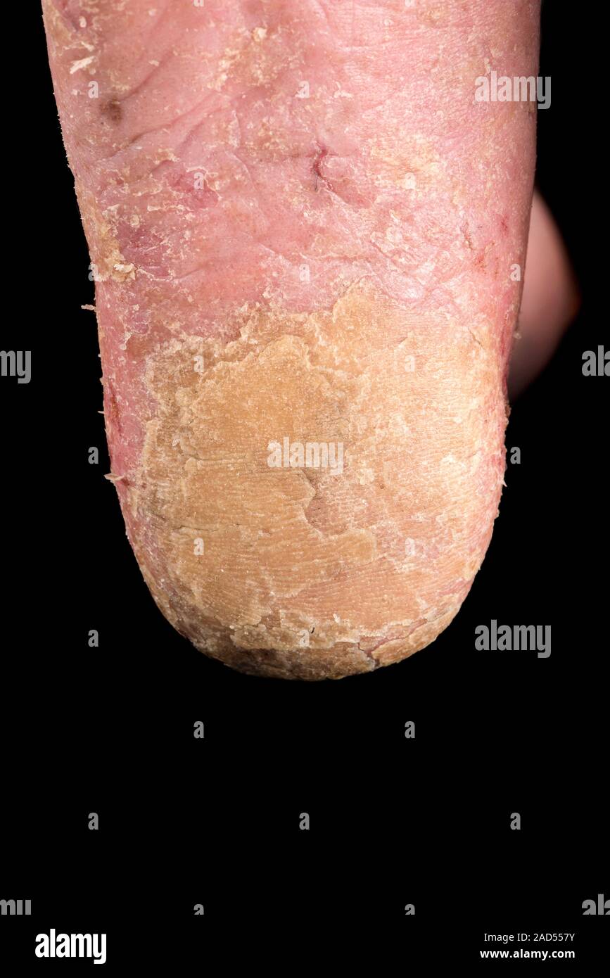 Psoriasis. Psoriasis affecting the heel of a 70-year-old male patient ...