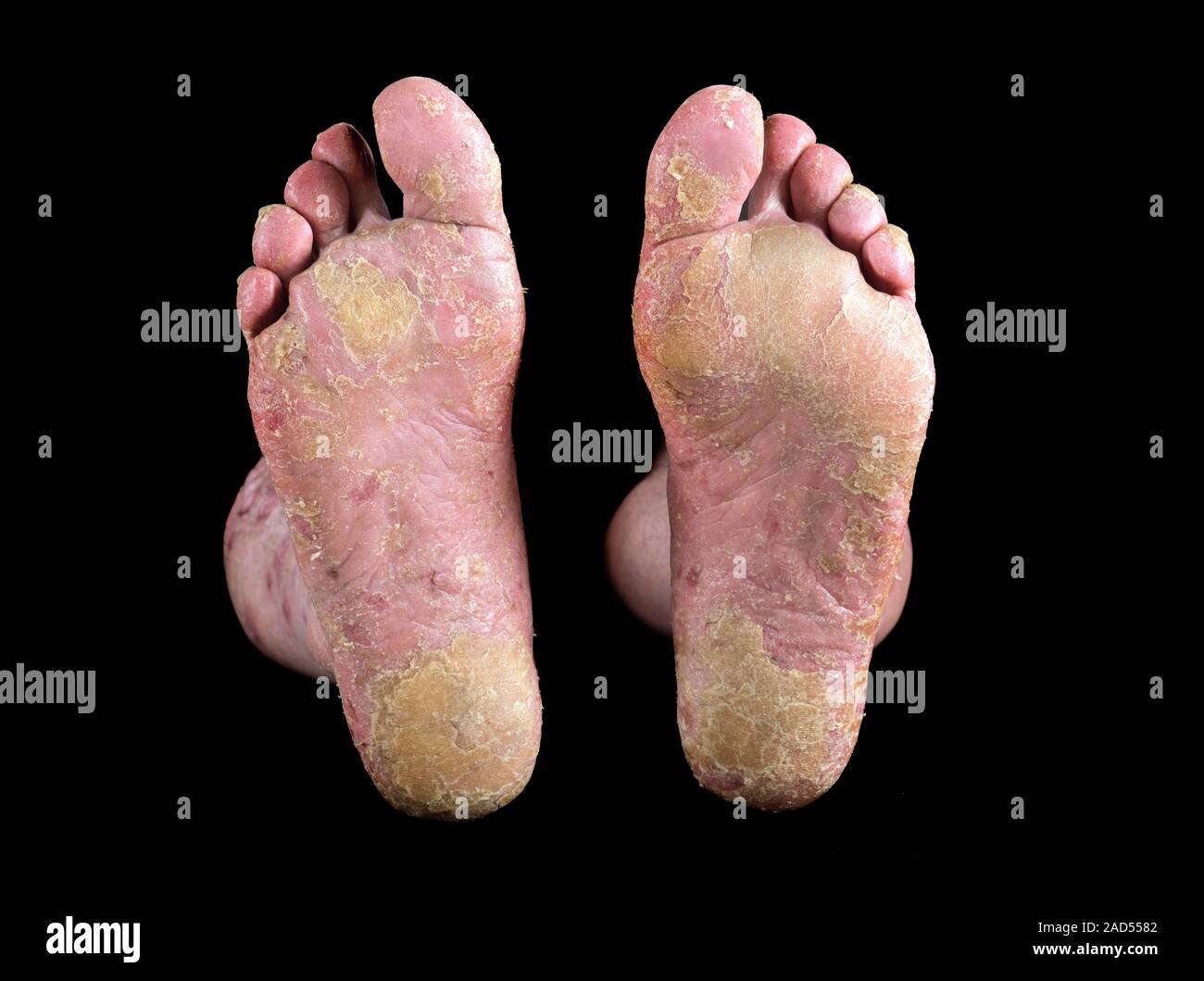 Psoriasis. Psoriasis affecting the soles of the feet of a 70-year-old ...