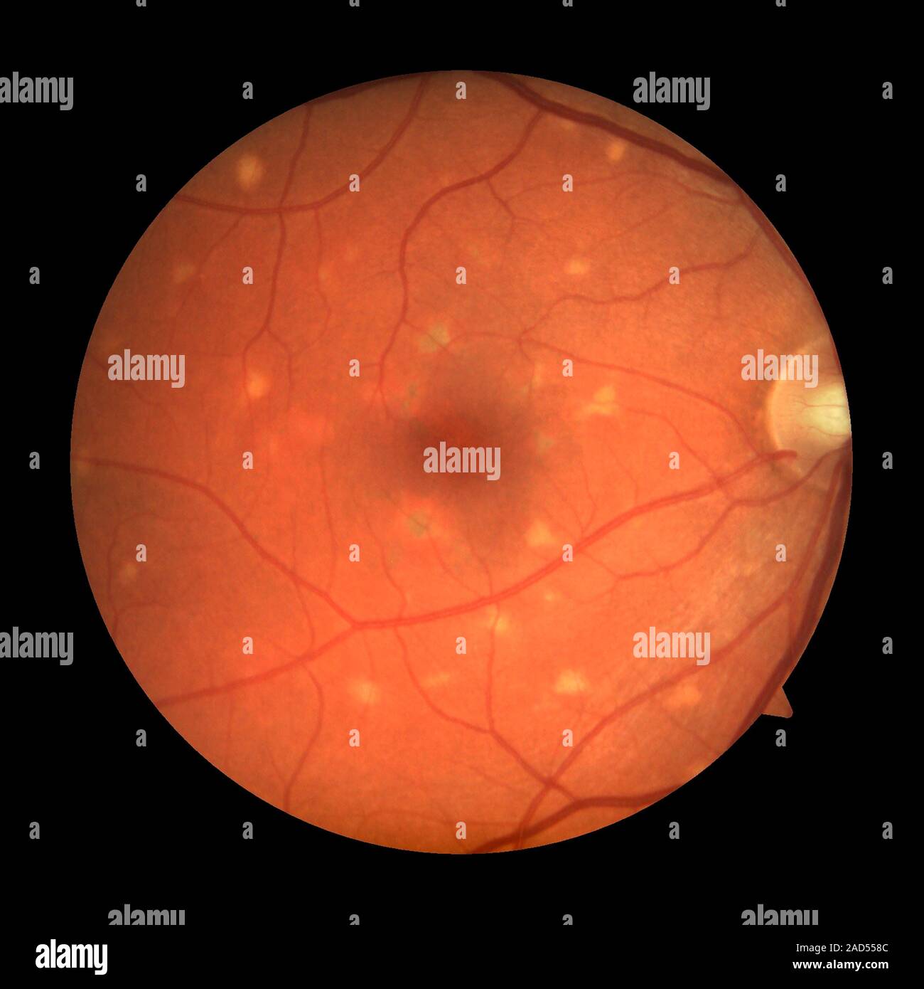 Ophthalmoscope image of the retina of a 55 year old male patient with ...