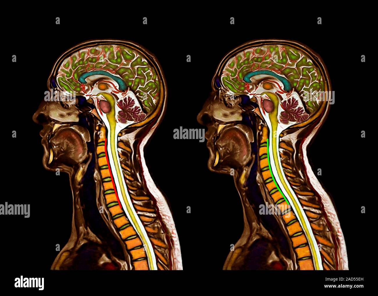 Curvature of the cervical spine. Colour-converted sagittal magnetic ...