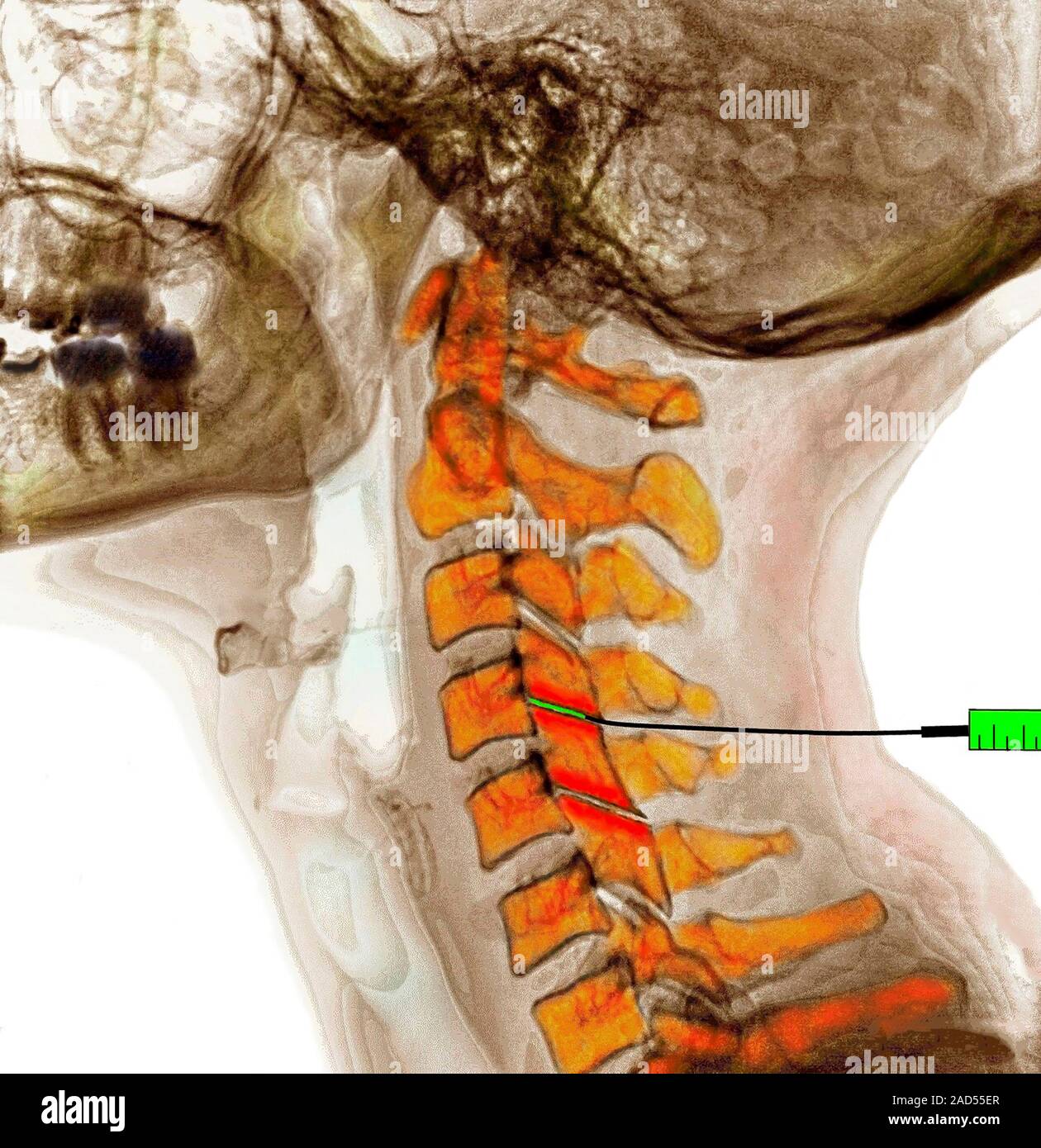 Spinal facet joint neck injection. Coloured lateral X-ray of the bones ...