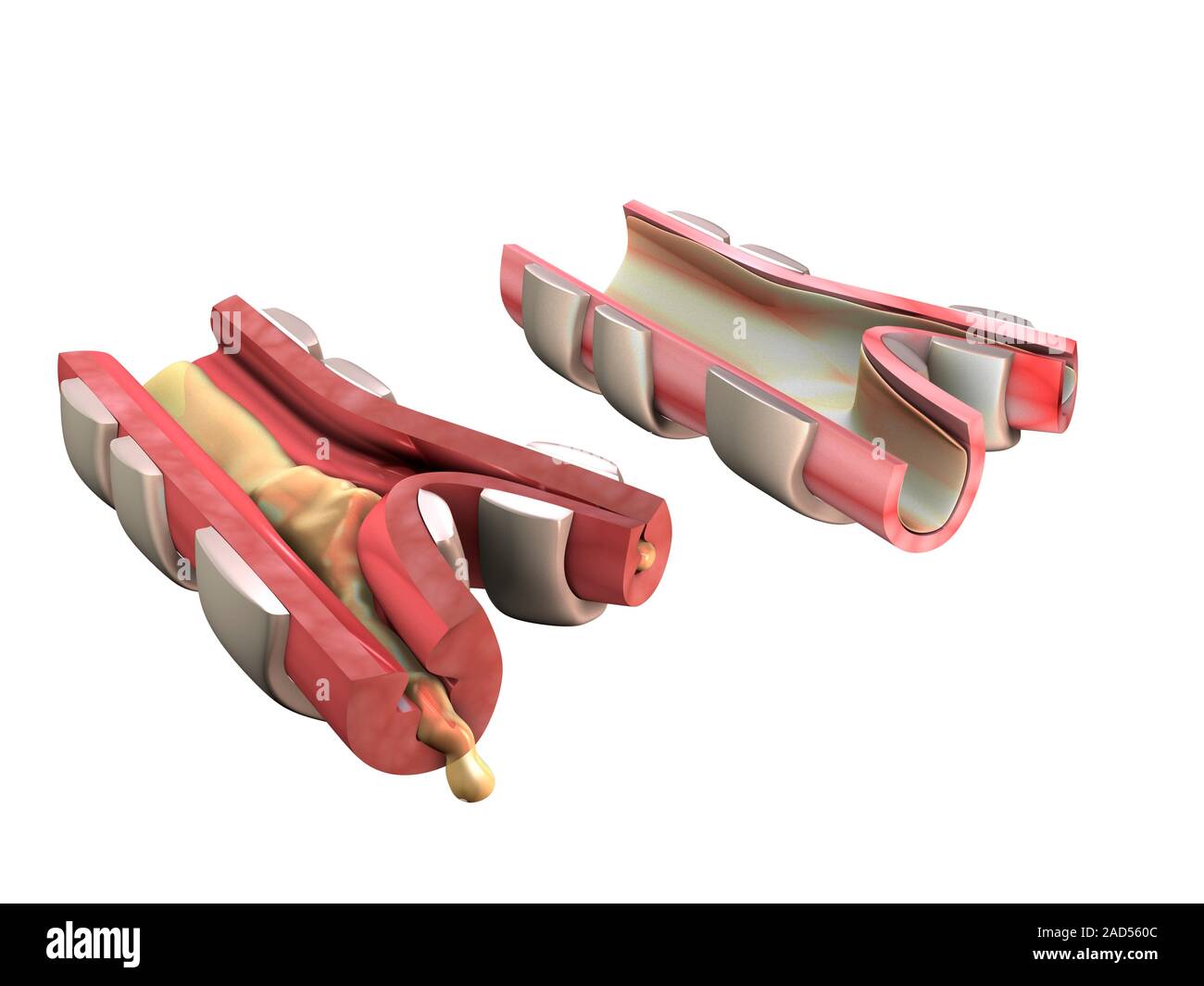 Airways in bronchitis. Illustration showing the airways (bronchi) of ...