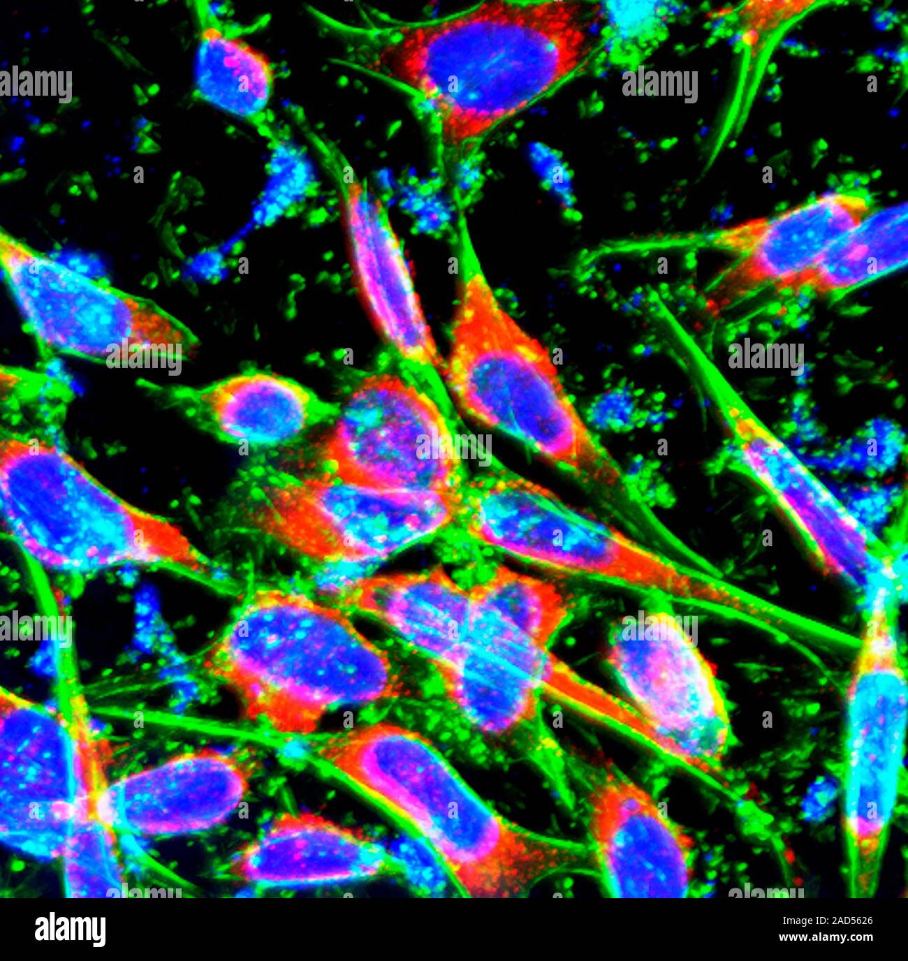 Colorectal cancer cells, fluorescence light micrograph. This study ...