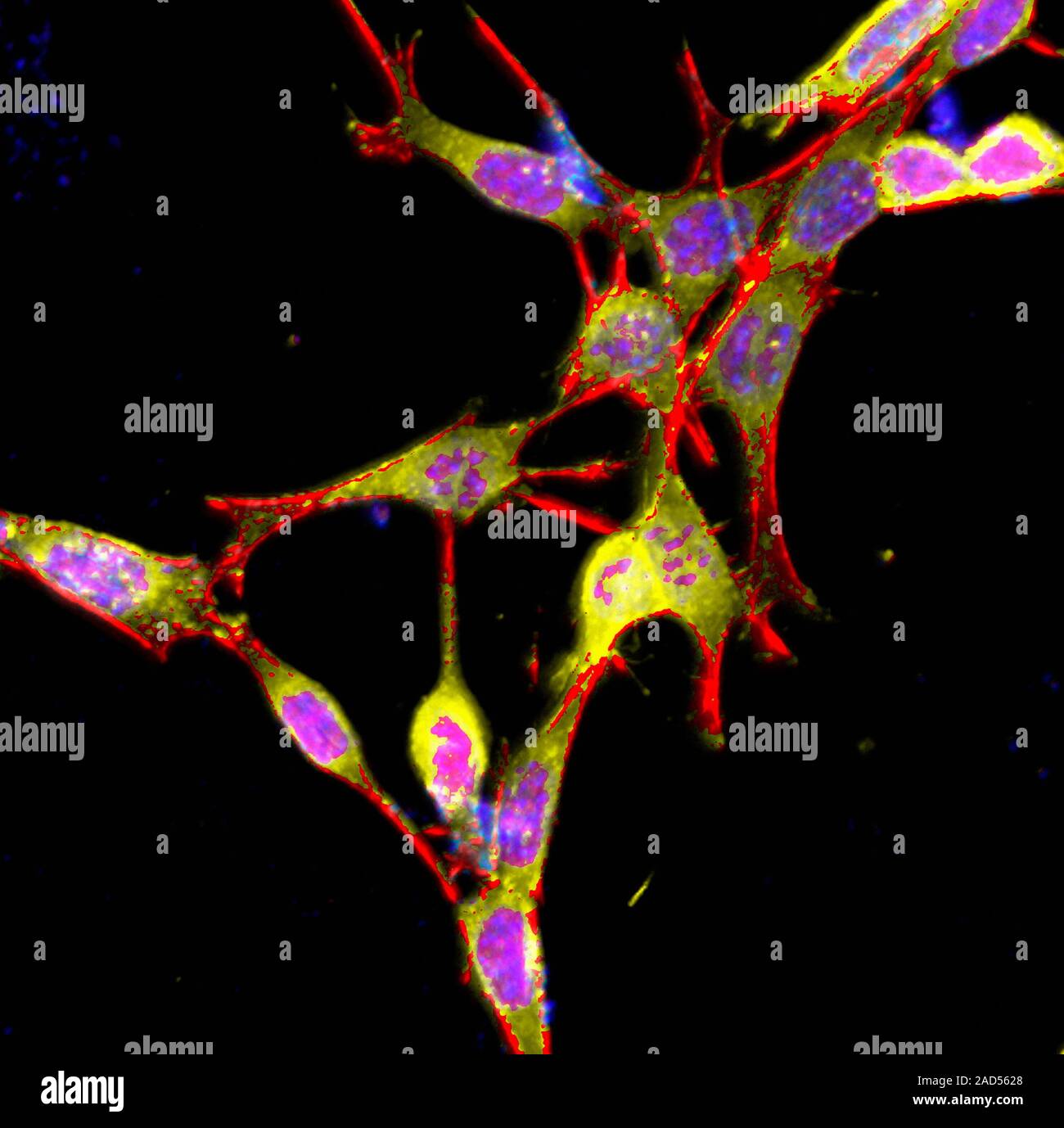 Colorectal cancer cells, fluorescence light micrograph. This study ...