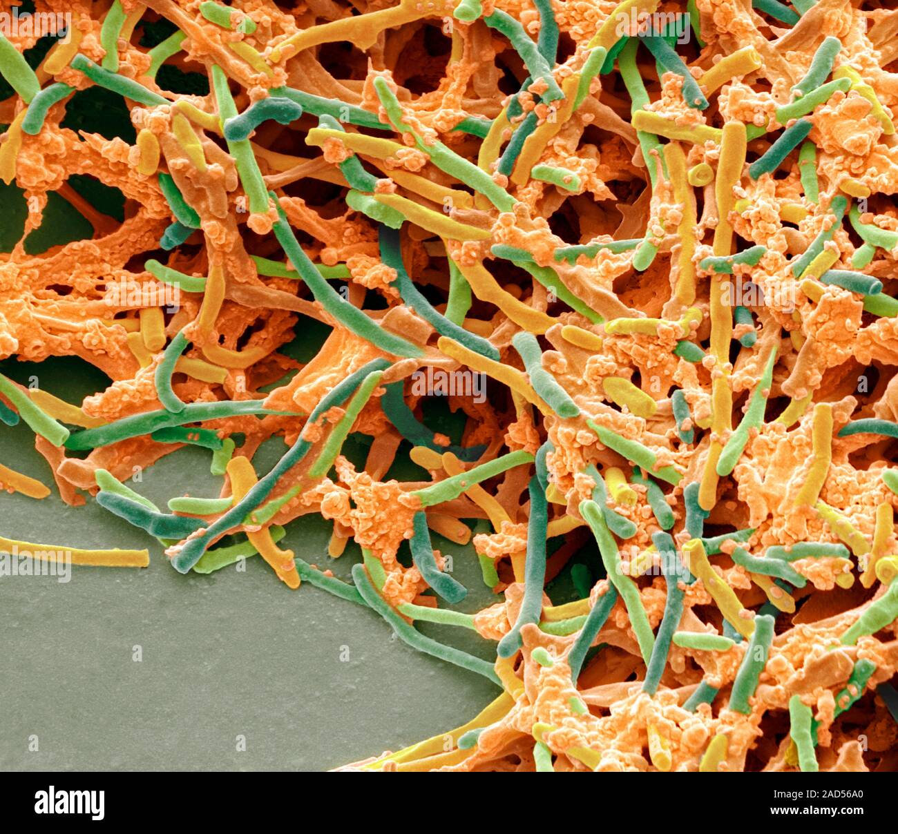 Actinomycosis. Scanning electron micrograph (SEM) from a patient with ...