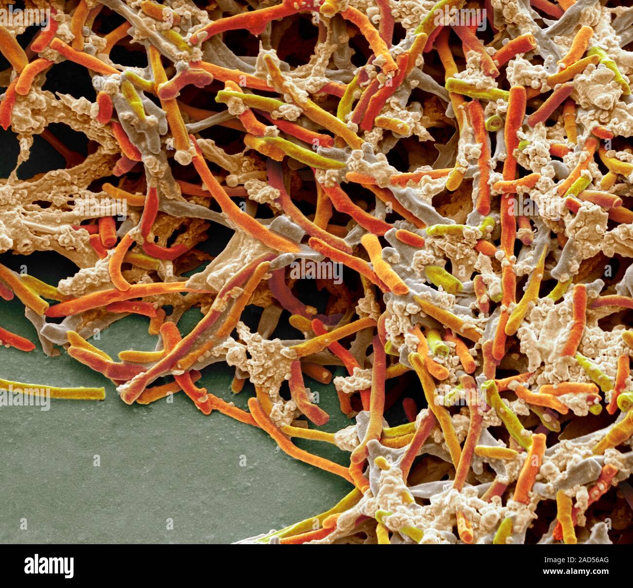 Actinomycosis. Scanning electron micrograph (SEM) from a patient with ...