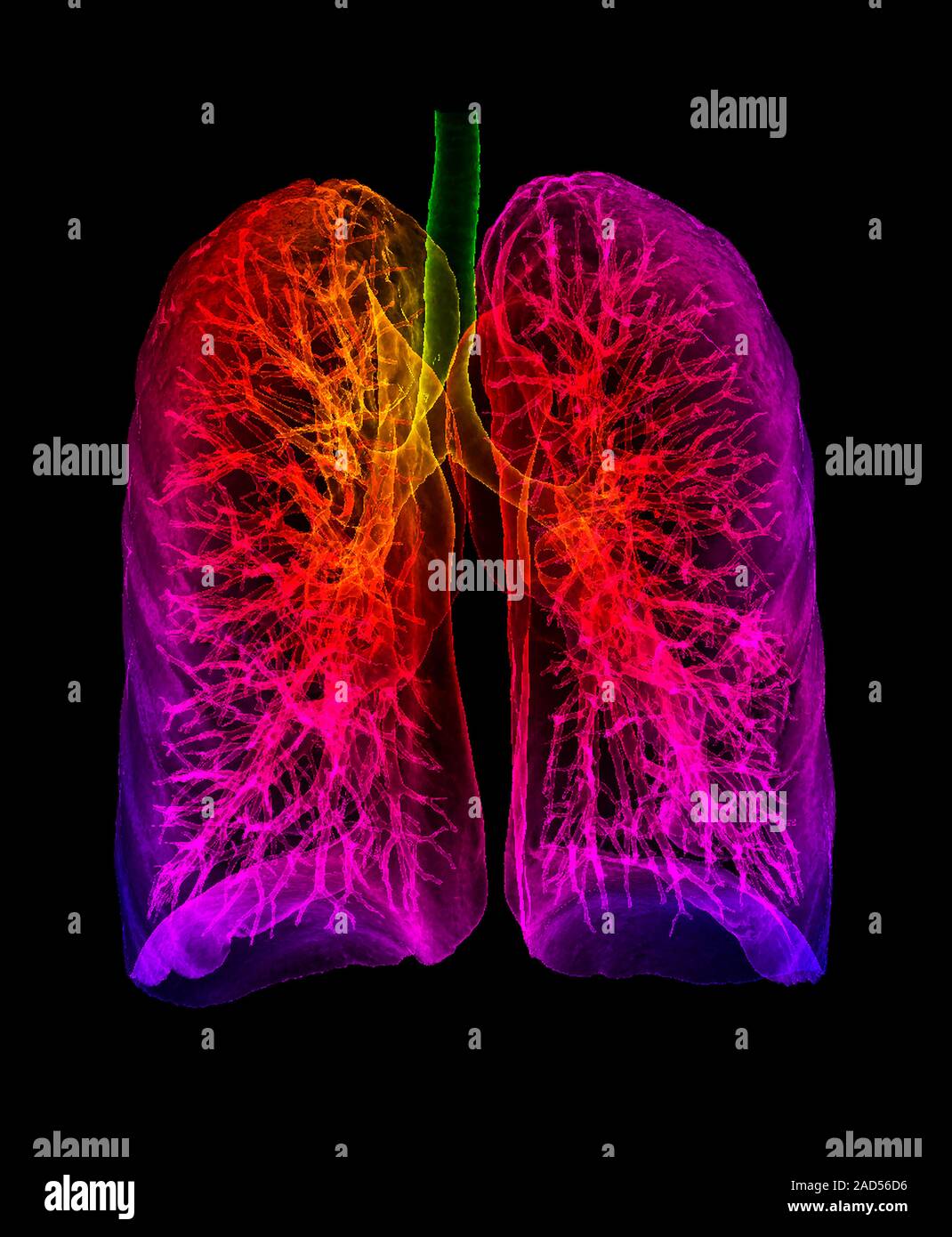 Human lungs. Coloured 3D computed tomography (CT) scan of normal human ...