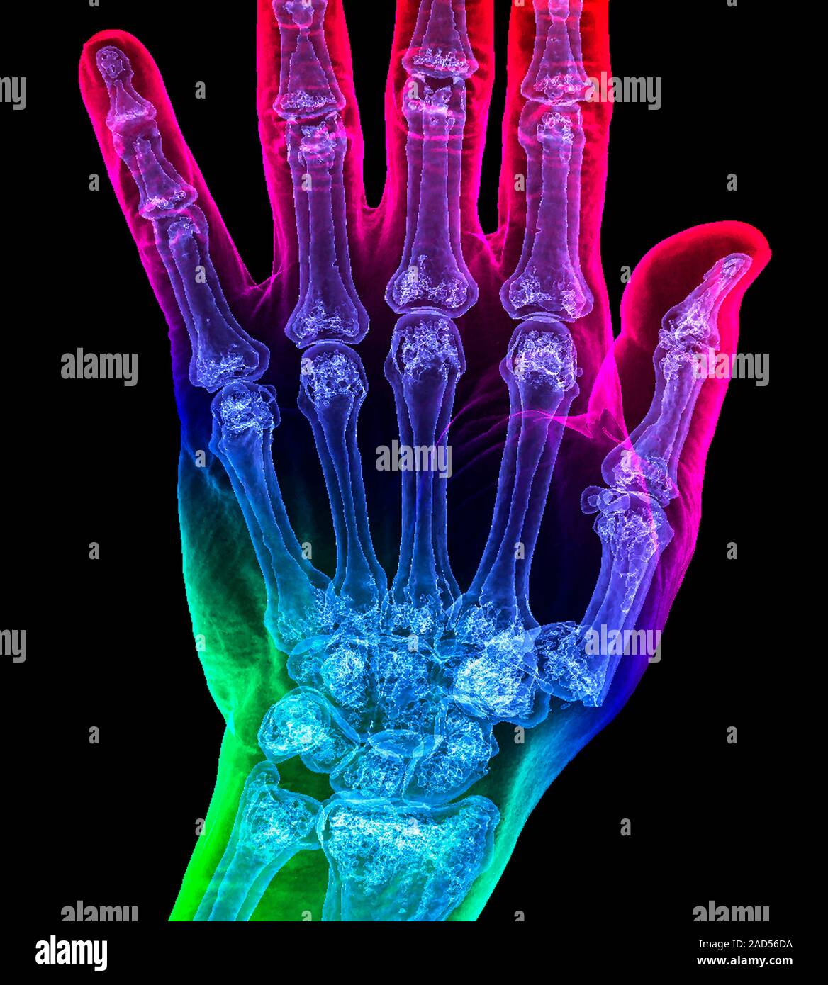 Thumb fracture. Coloured 3D computed tomography (CT) scan showing the ...