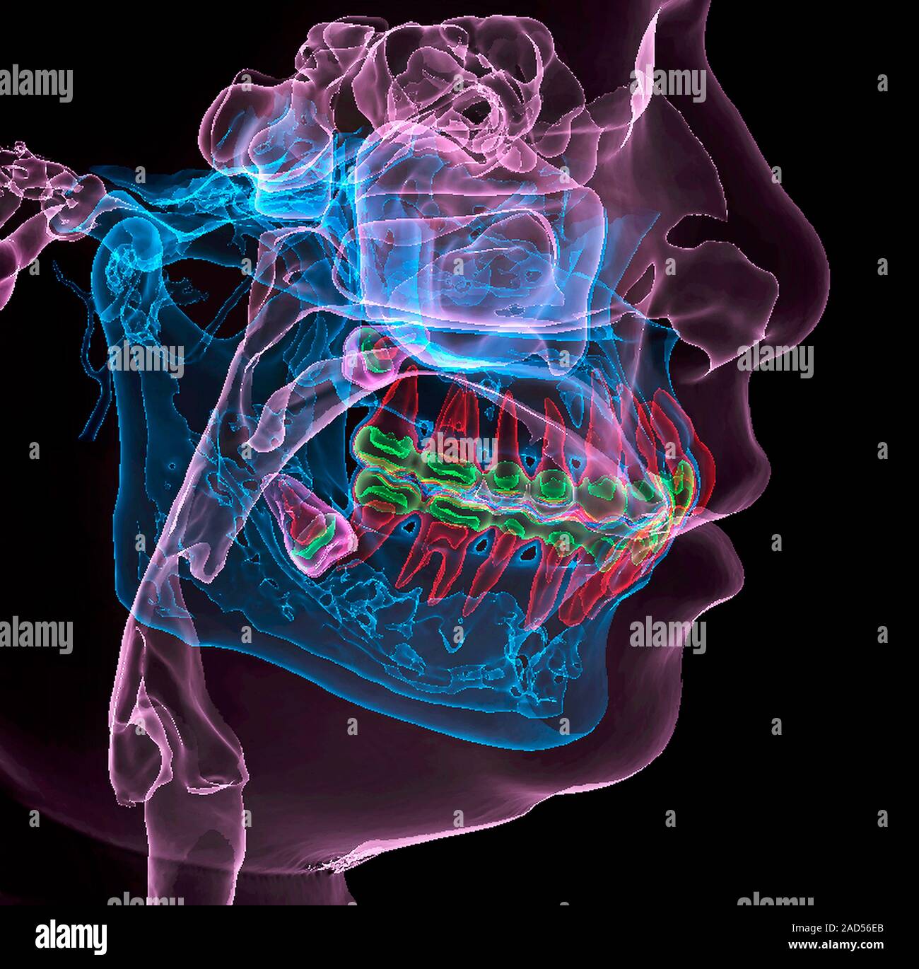 Impacted molar teeth. Coloured 3D computed tomography (CT) scan of a ...