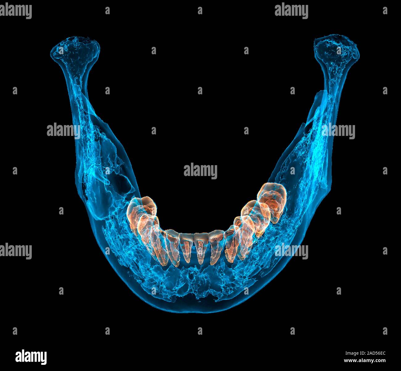 Bone tumour. Coloured 3D computed tomography (CT) scan of the mandible ... Bone tumour. Coloured 3D computed tomography (CT) scan of the mandible ...