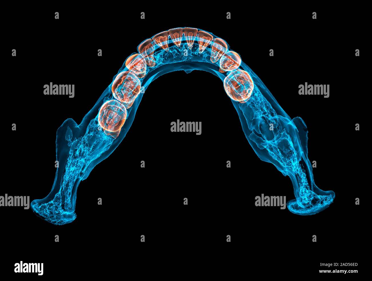 Bone tumour. Coloured 3D computed tomography (CT) scan of the mandible ... Bone tumour. Coloured 3D computed tomography (CT) scan of the mandible ...