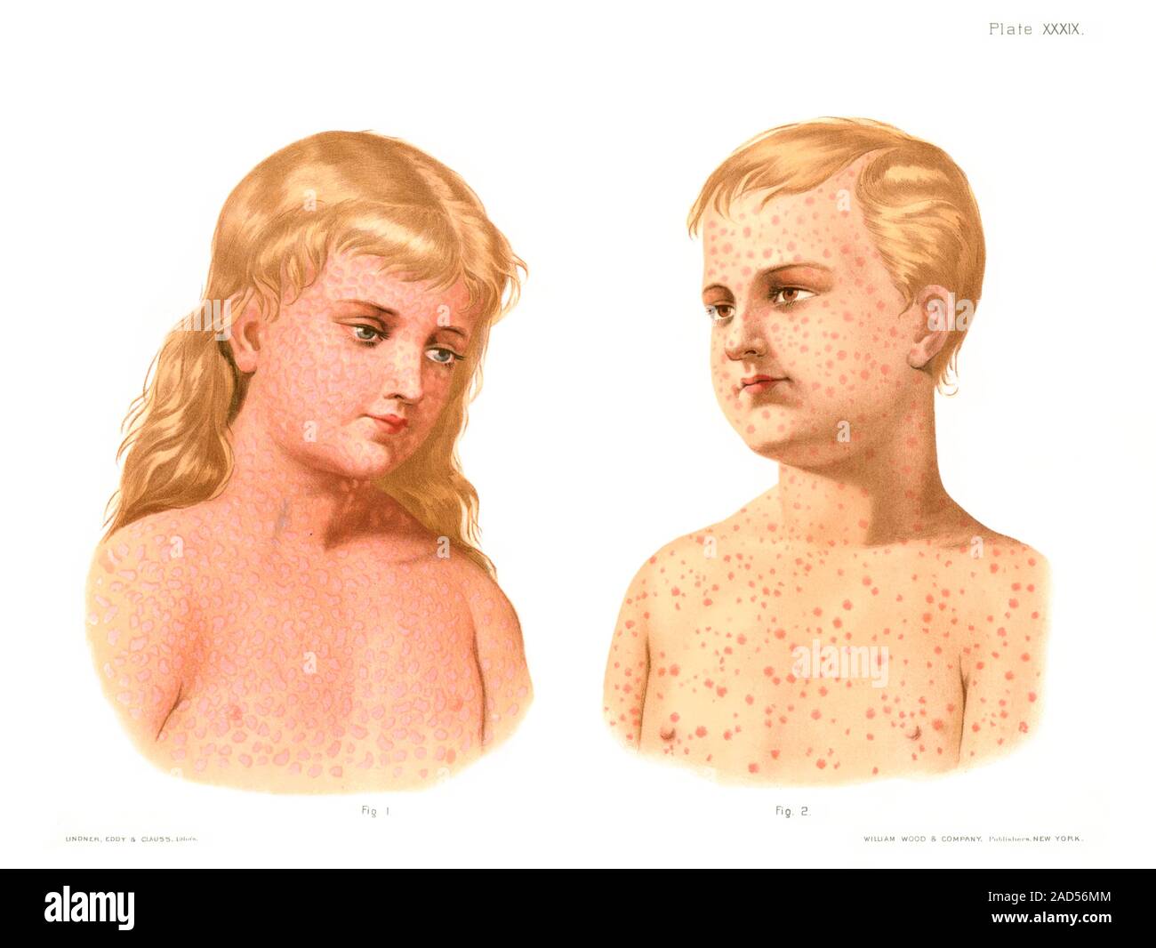 Measles and German measles. Historical medical illustration showing ...