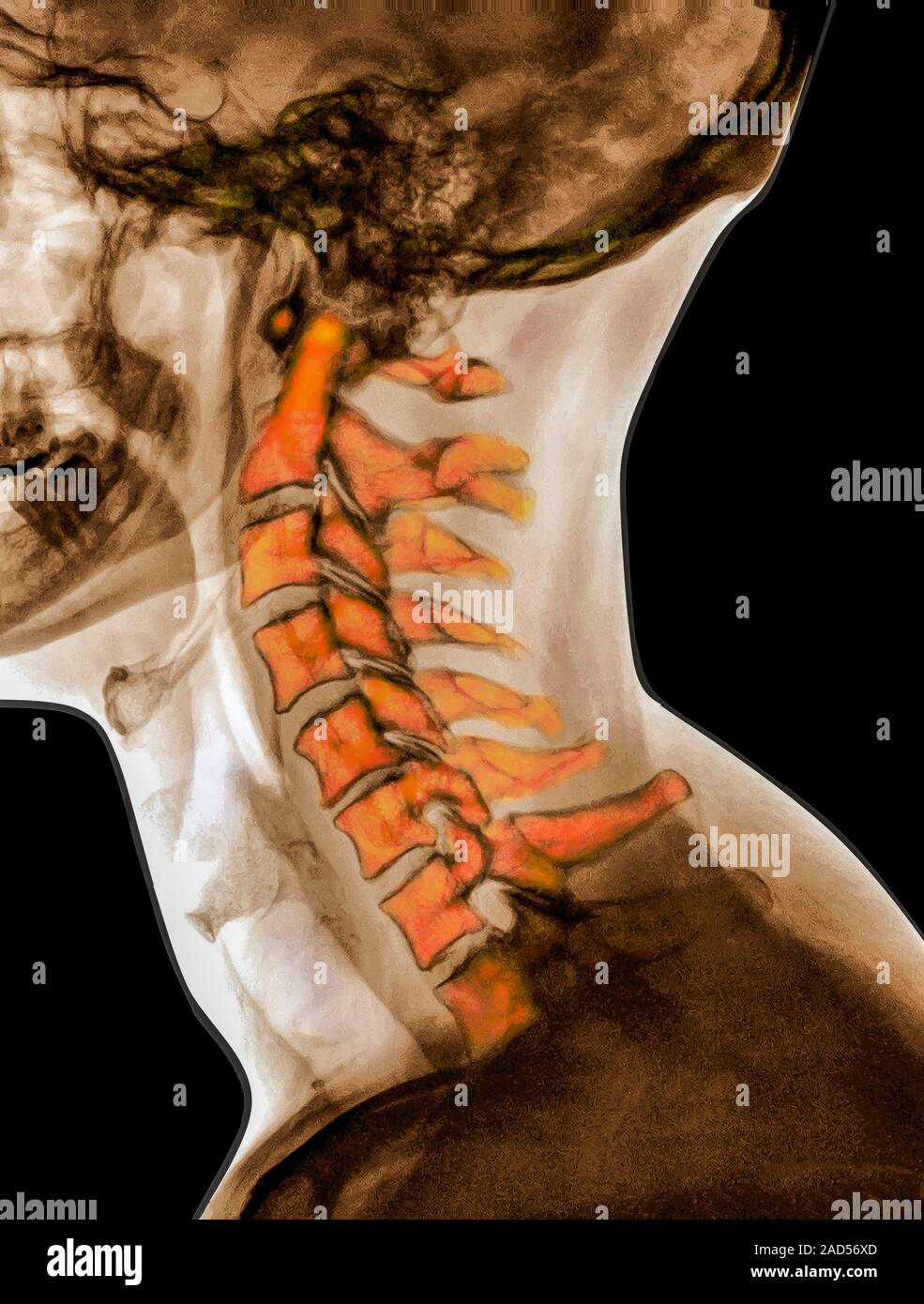 Curvature of the cervical spine. Coloured lateral X-ray of a human head ...