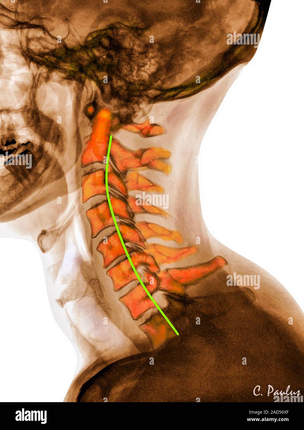 Curvature of the cervical spine. Coloured lateral X-ray of a human head ...
