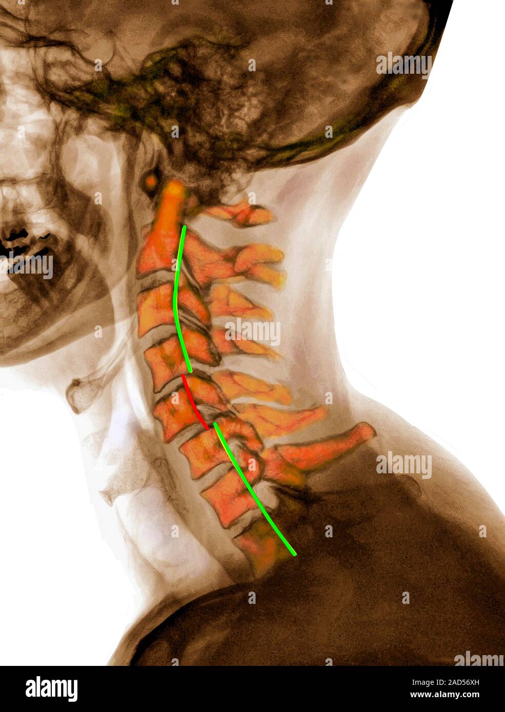 Dislocated cervical vertebra. Coloured lateral X-ray of a human head ...