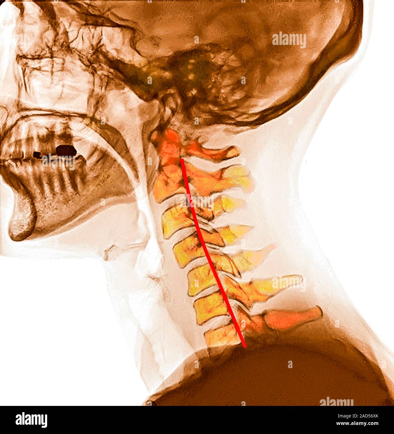 Straightened neck curvature. Coloured lateral X-ray of a human head and ...
