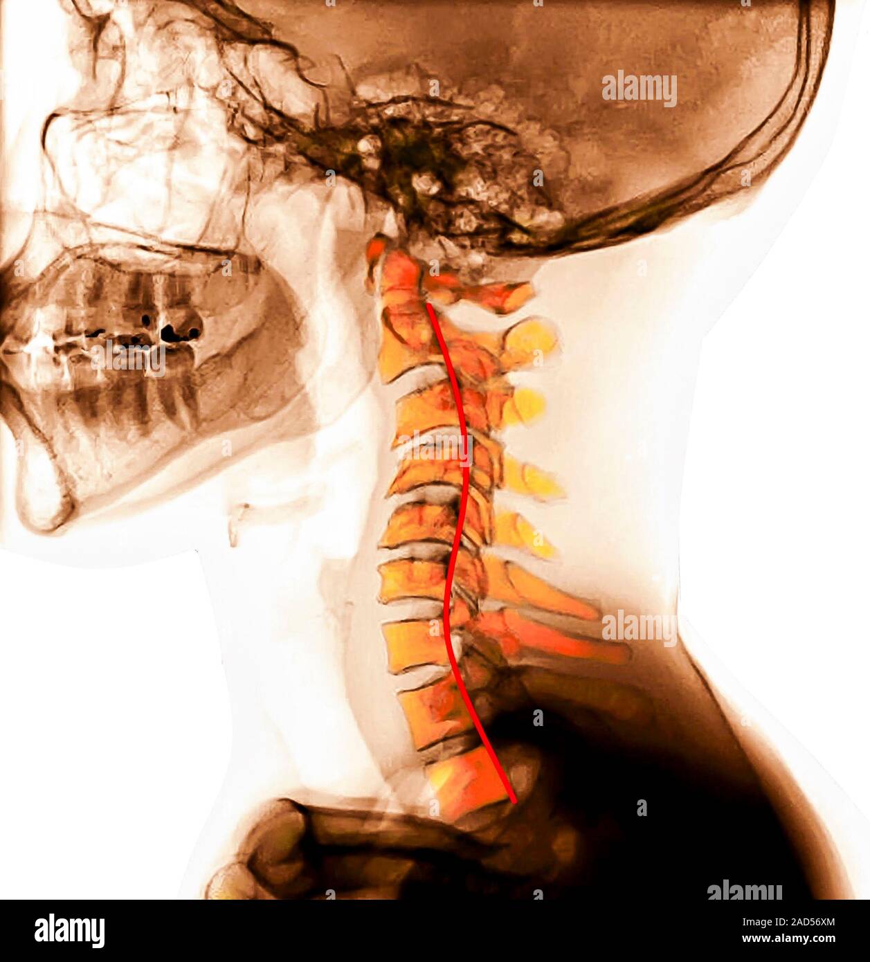 Kyphosis of the cervical spine. Coloured lateral X-rays of a human head ...