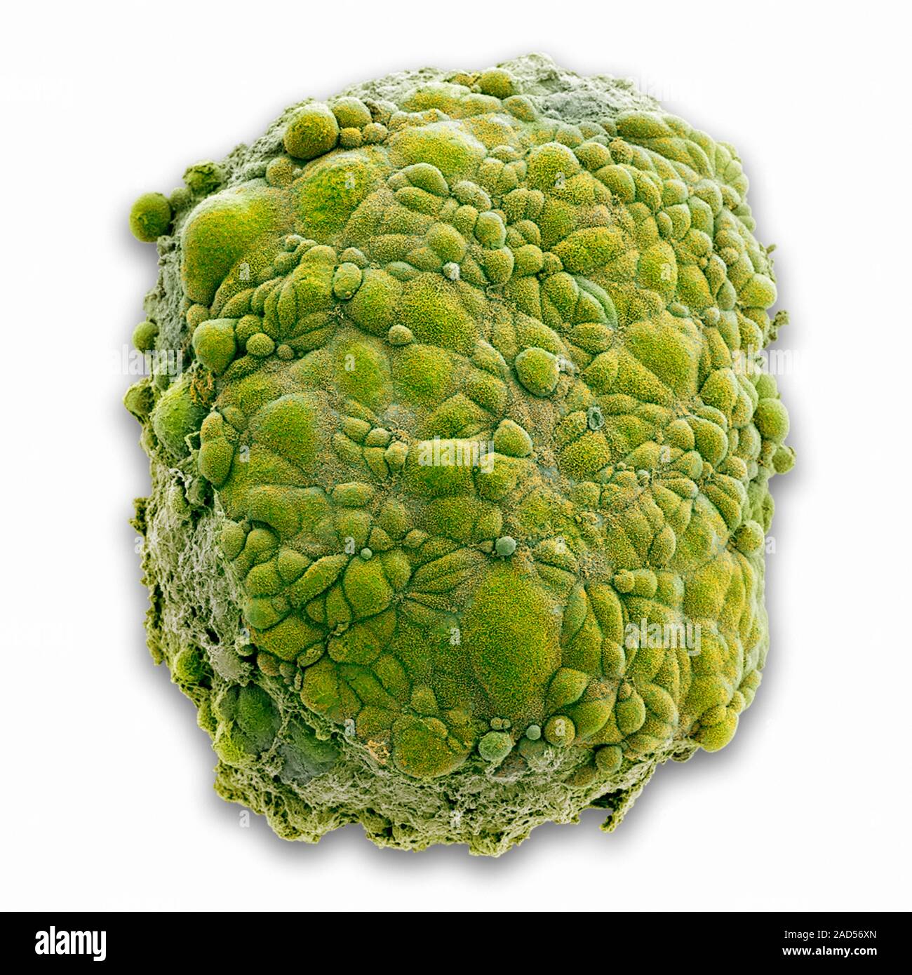 Mesothelioma spheroid. Coloured scanning electron micrograph (SEM) of a ...