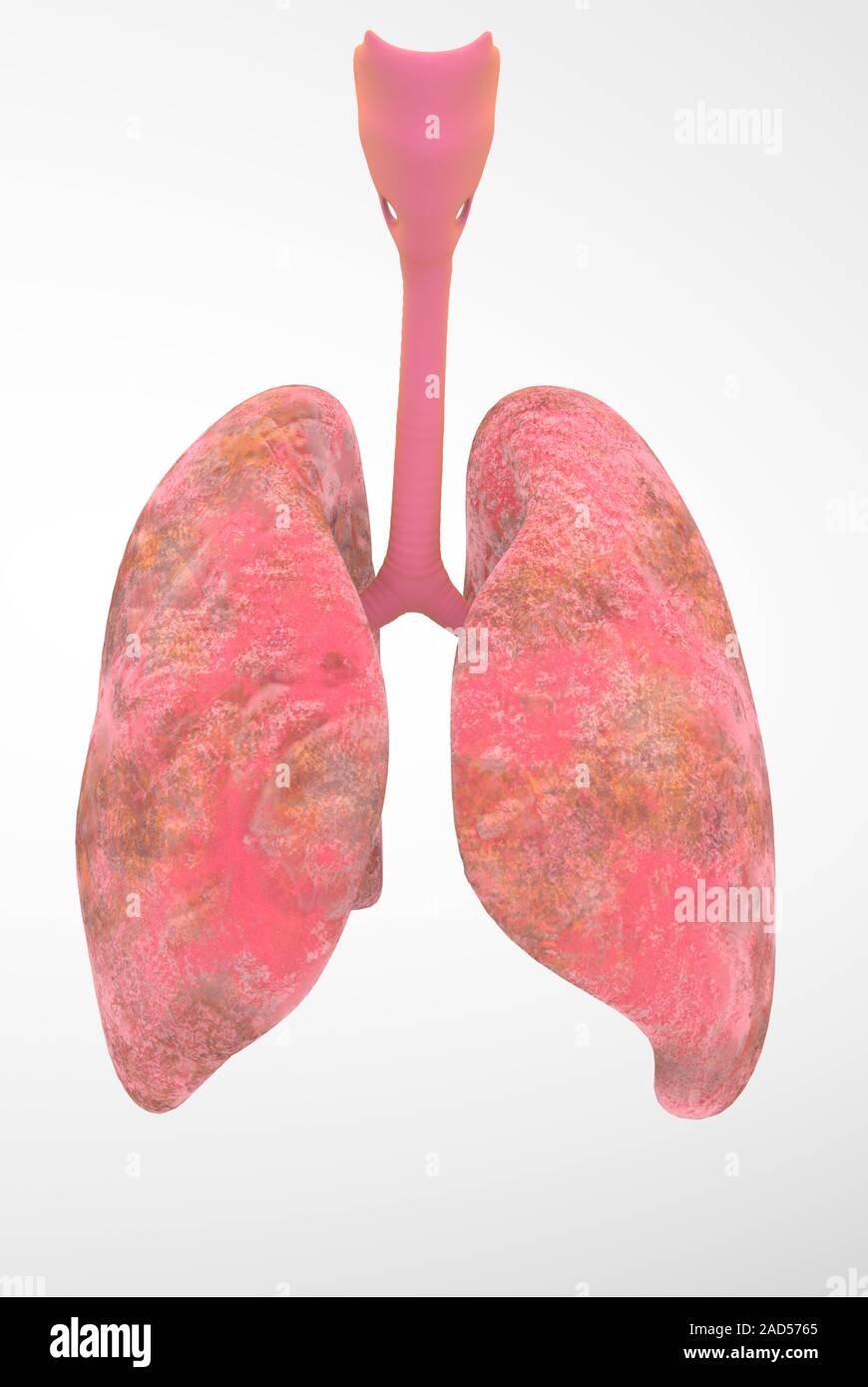 Smoker's lungs. Illustration of lungs moderately damaged by smoking. At ...