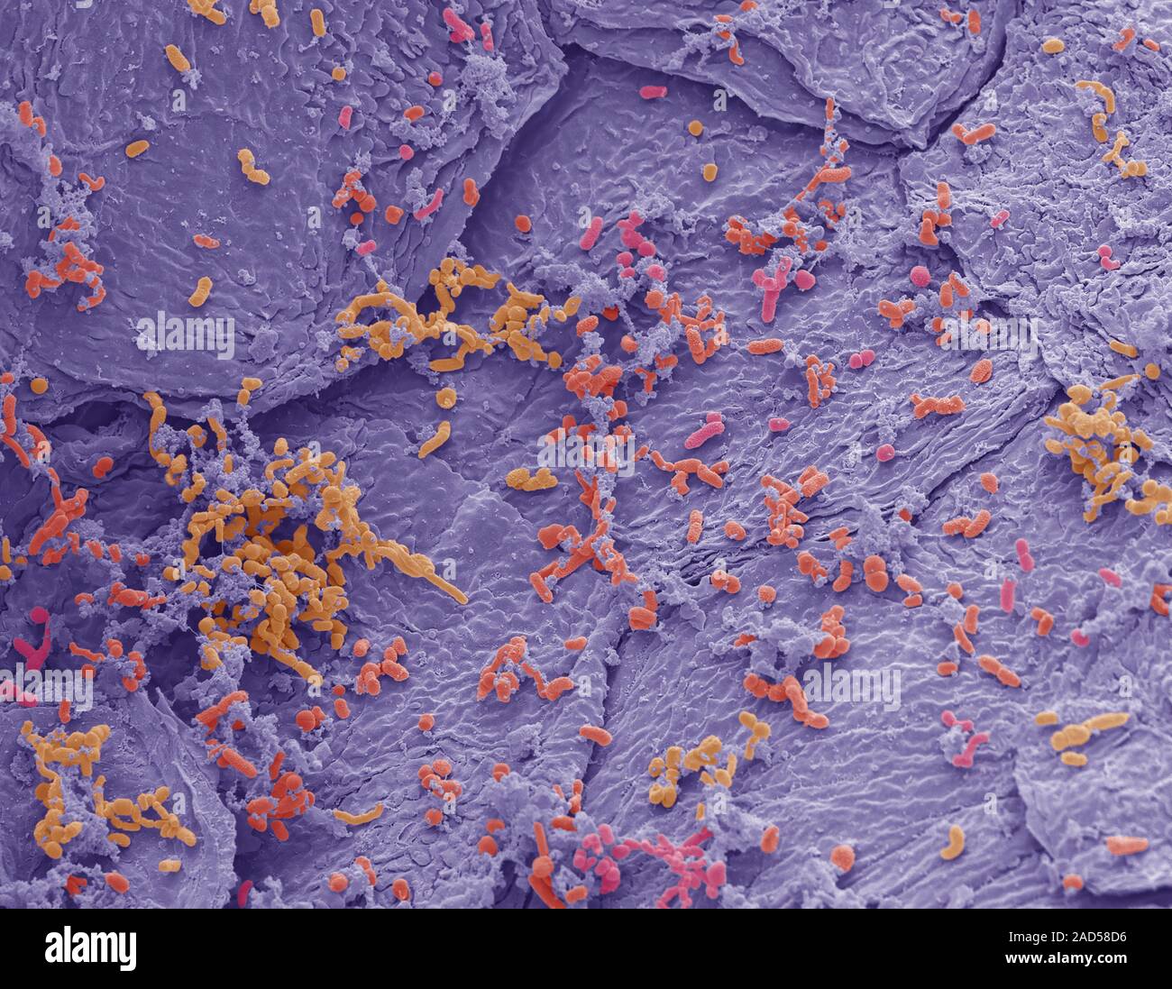 Bacterial skin infection. Coloured scanning electron micrograph (SEM ...