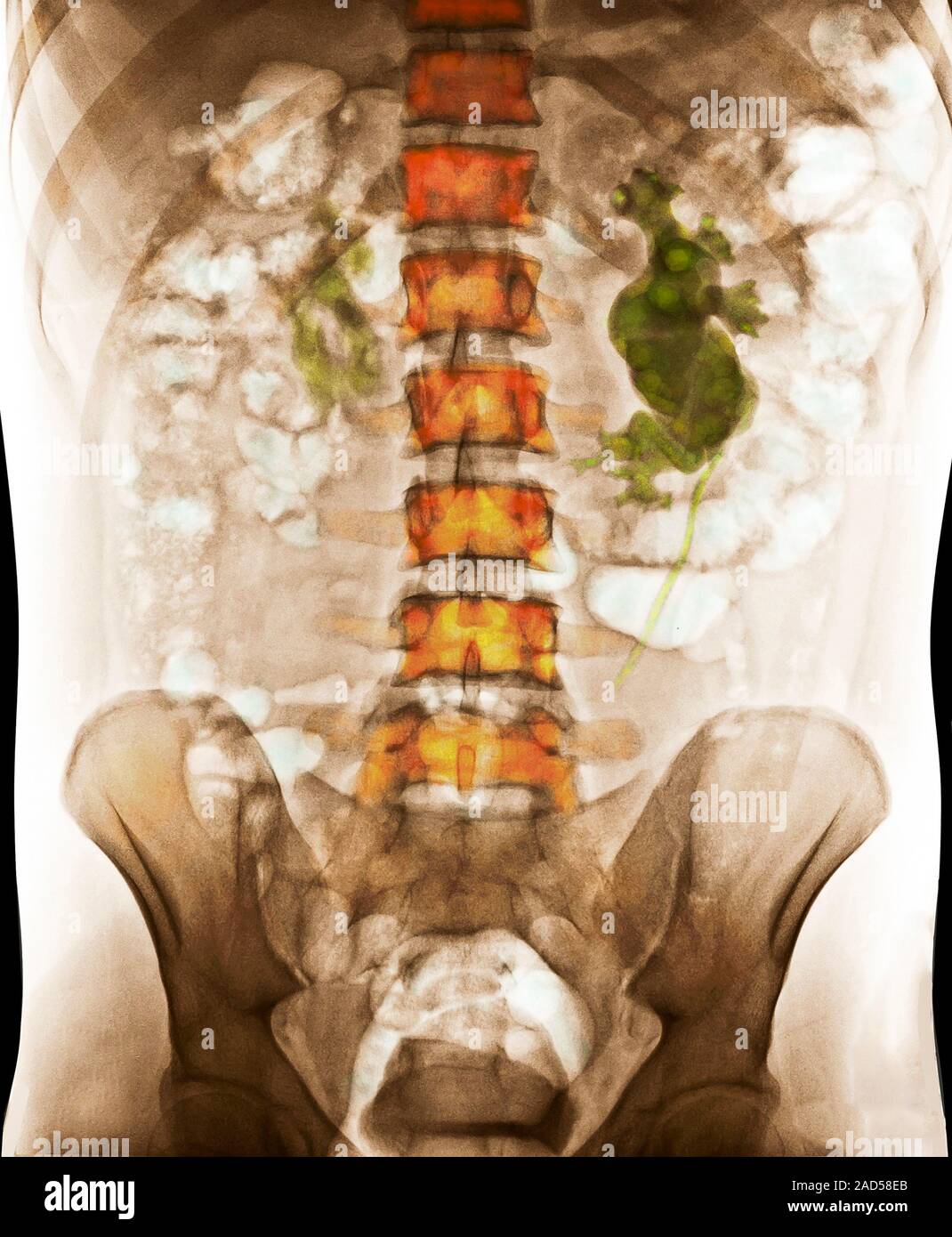 Dilated kidney. Coloured X-ray of the abdomen of a 38-year-old woman ...