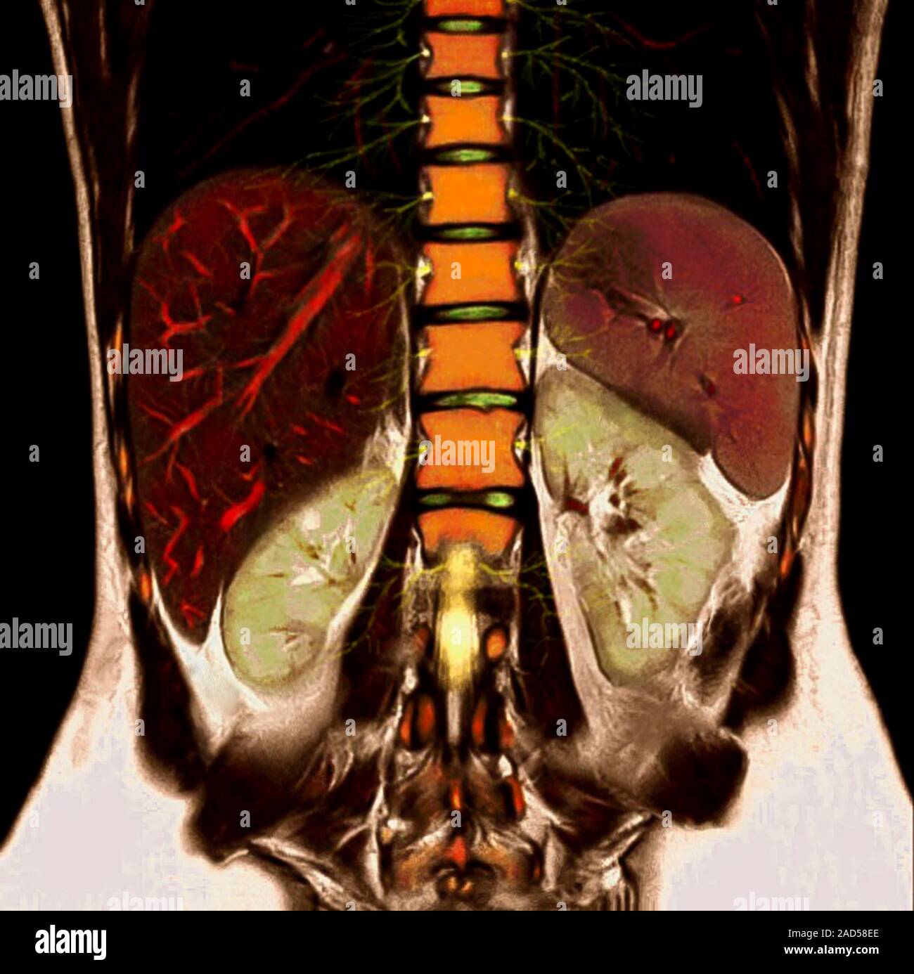Abdominal organs and spine. Coloured coronal magnetic resonance imaging ...