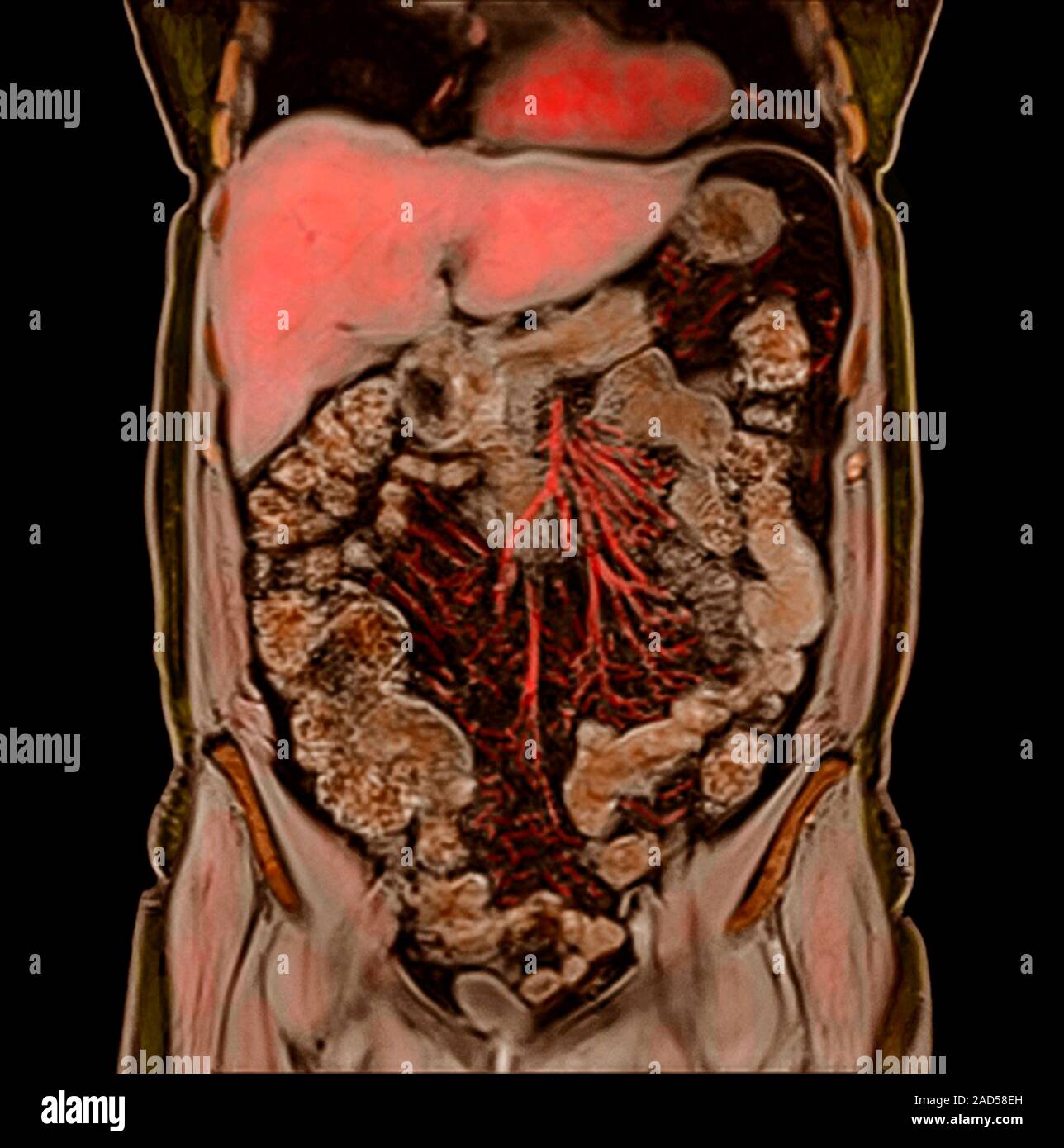 Abdominal organs. Coloured 3D coronal magnetic resonance imaging (MRI ...