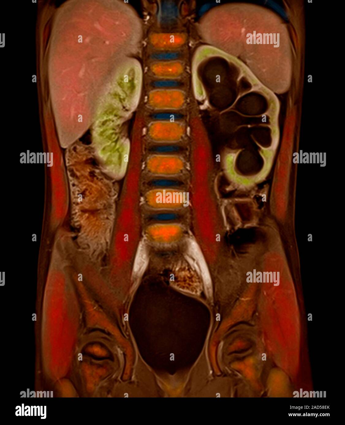Dilated kidney. Coloured coronal magnetic resonance imaging (MRI) scan ...