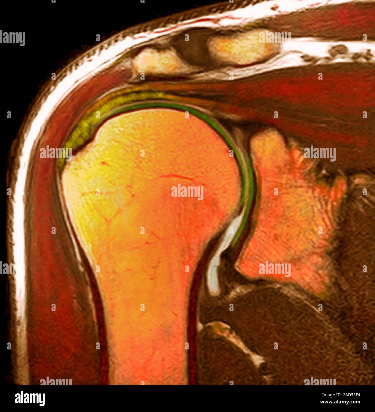 Shoulder joint. Coloured magnetic resonance imaging (MRI) scan of a ...